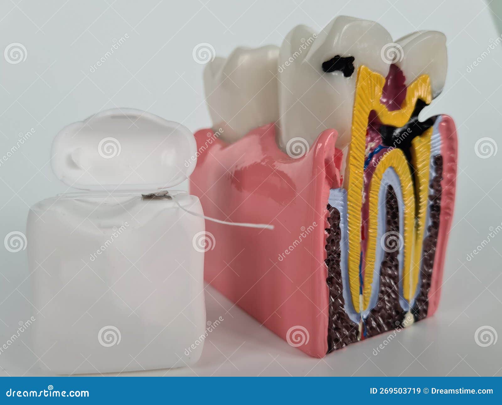 Dental Care and Tooth with Caries. Teeth Model with Dental Floss Stock ...