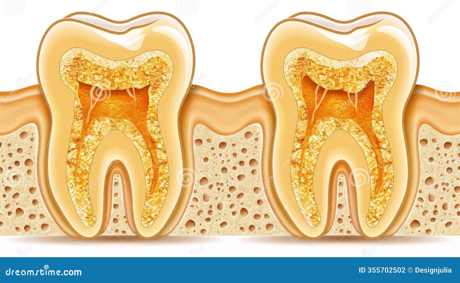 Dental Caries Cross-Section of Two Teeth with Advanced Tooth Decay ...