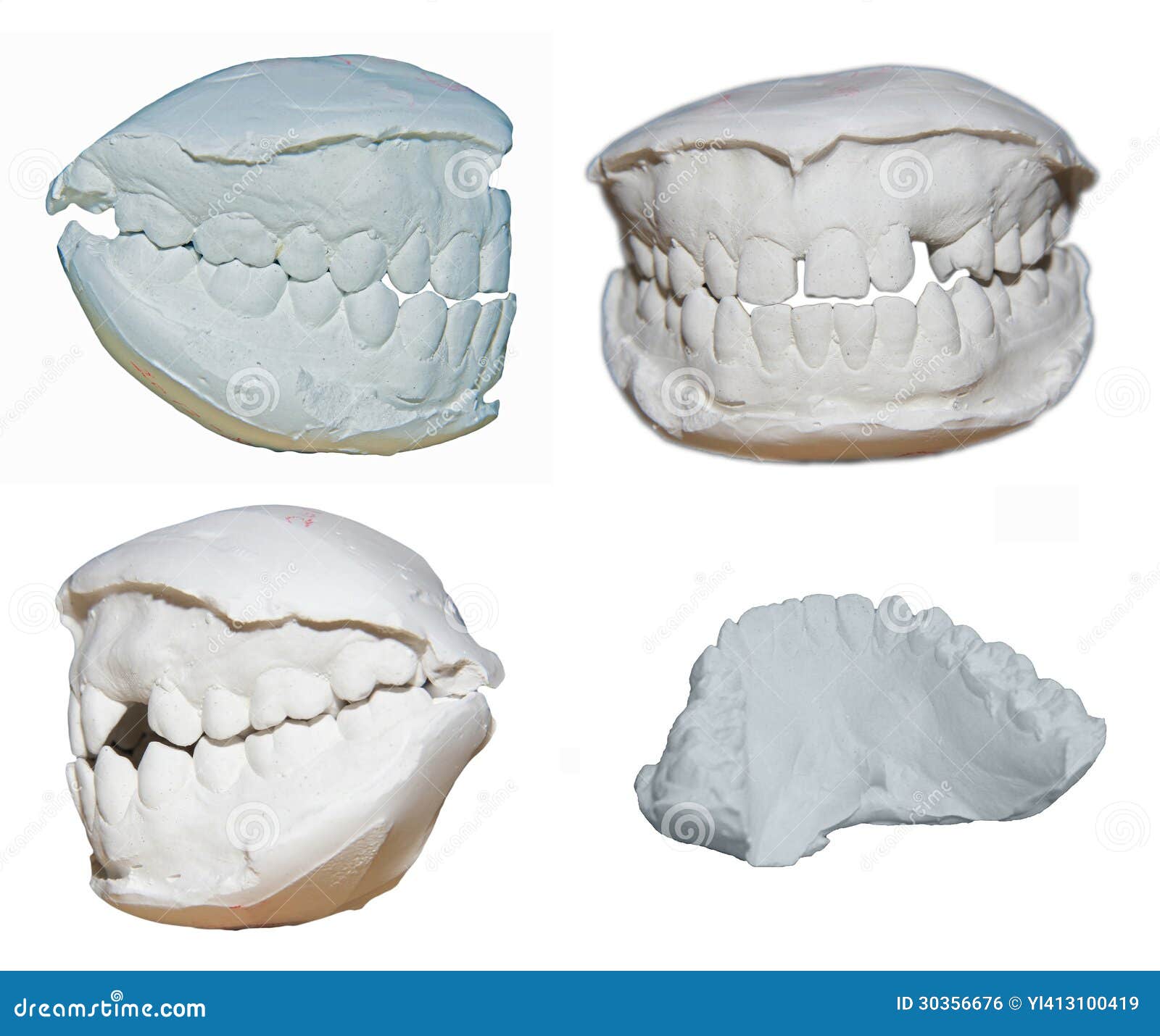 Dental cast stock photo. Image of white, healthcare, plaster - 30356676