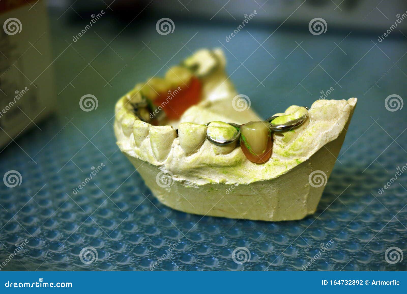 Dental Cast with Tooth Insert Implant on Table Stock Photo - Image of ...