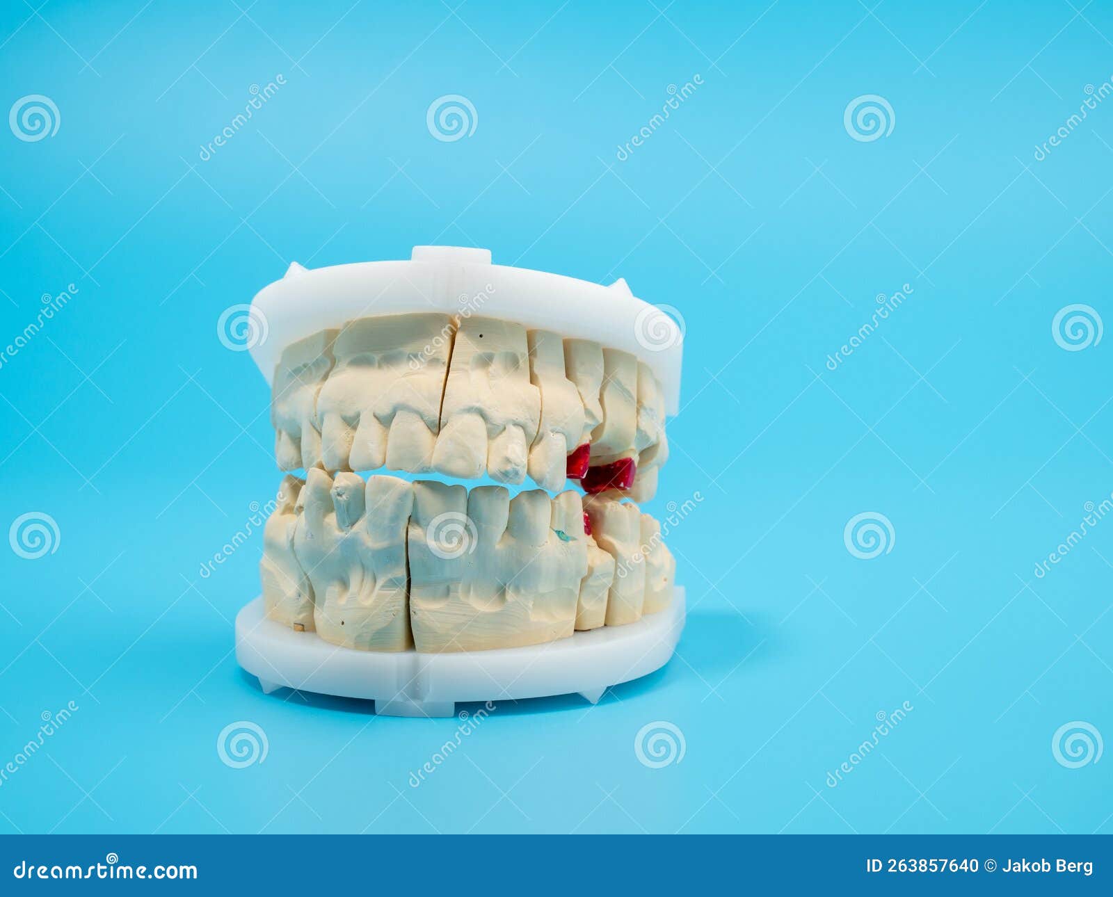 Dental Casts on a Blue Background. Plaster Model of Teeth Stock Photo ...
