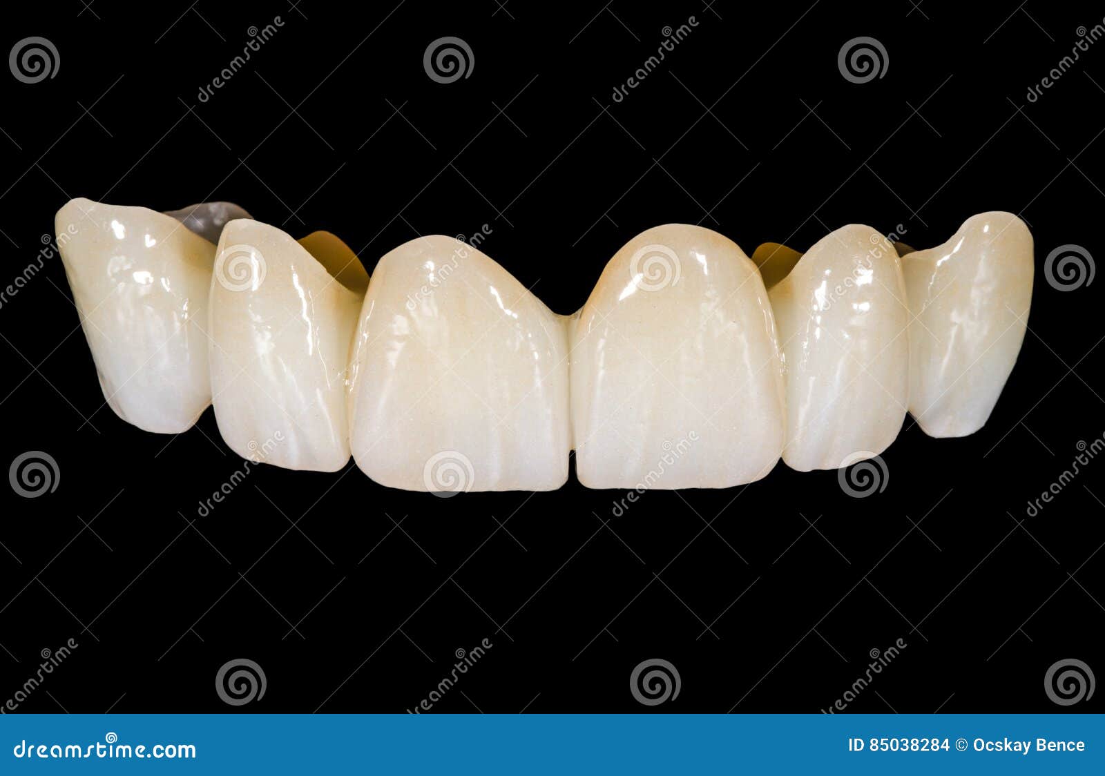 Dental ceramic bridge stock photo. Image of porcelain - 85038284