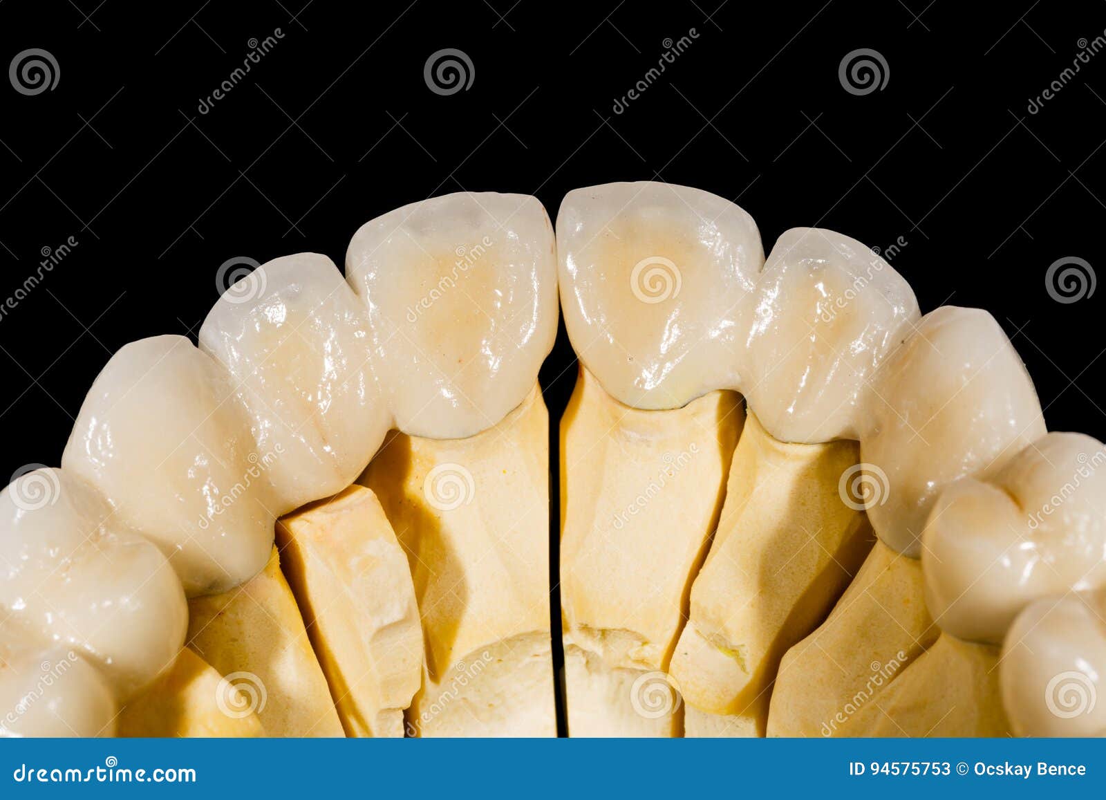 Dental ceramic bridge stock image. Image of model, cast - 94575753
