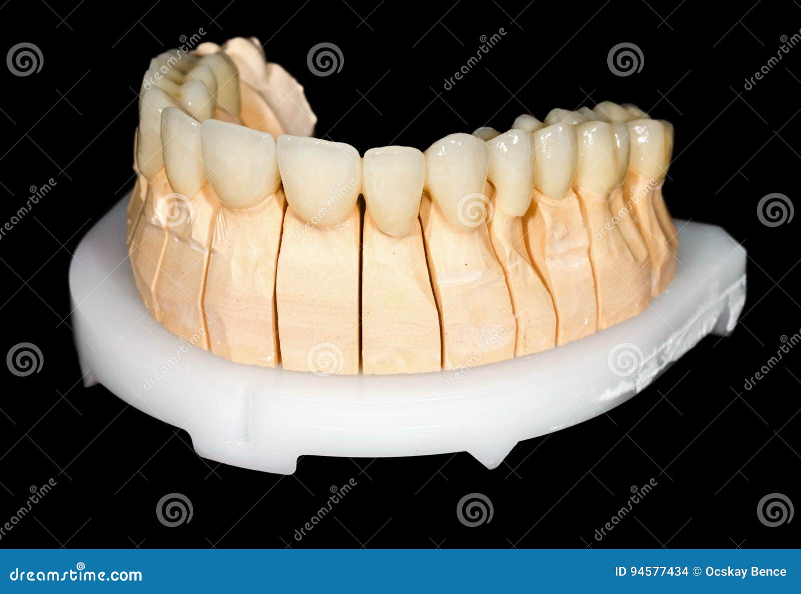 Dental ceramic bridge stock photo. Image of partial, denture - 94577434