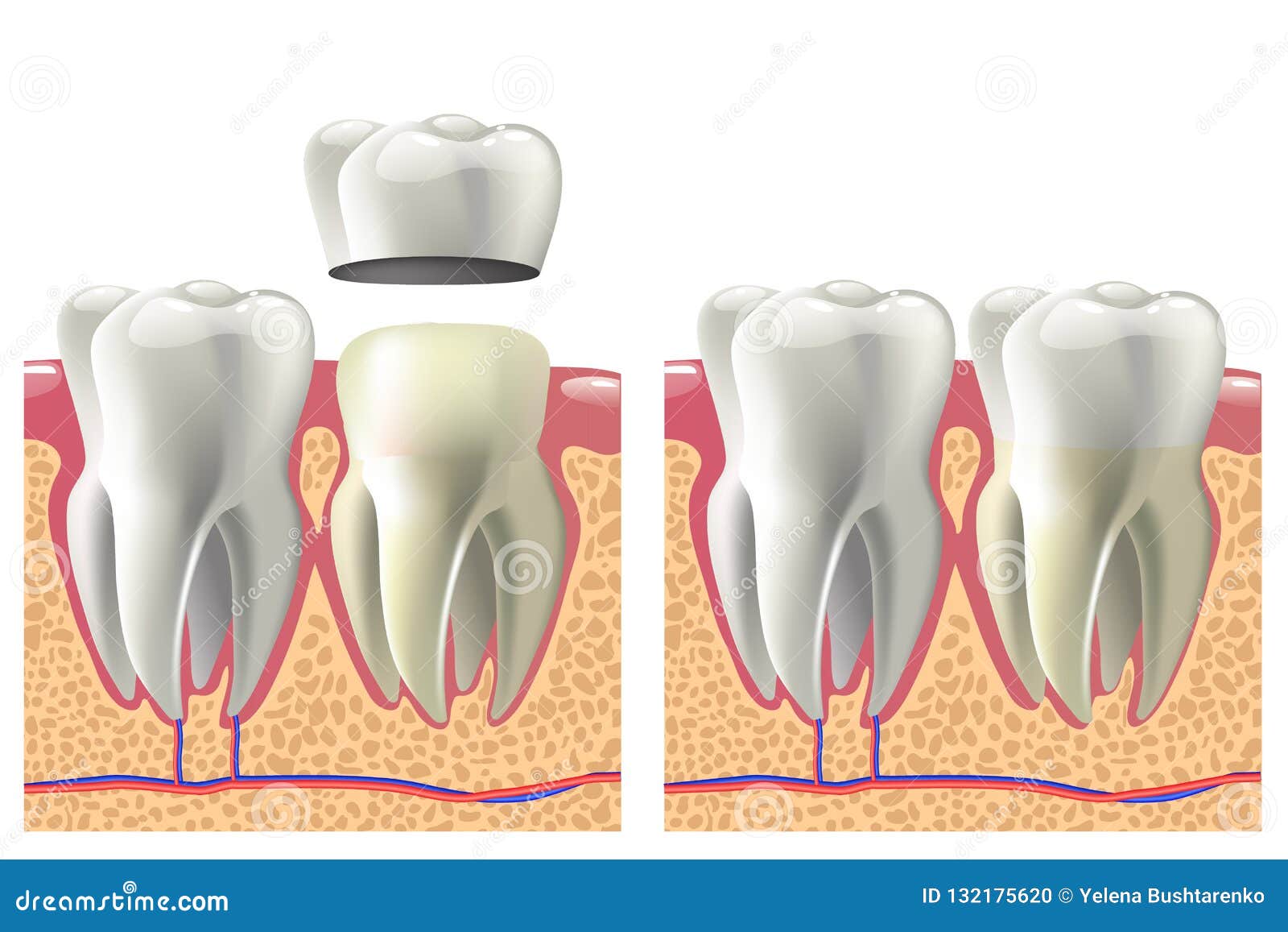 Dental Crown Installation Process. Dental Care Concept. Stock Vector ...