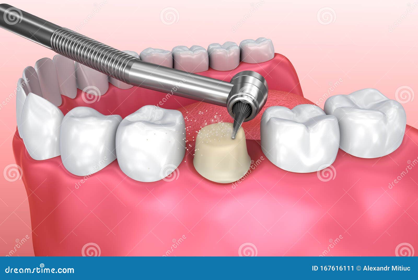 Dental Crown Installation Process Stock Image | CartoonDealer.com #61085977