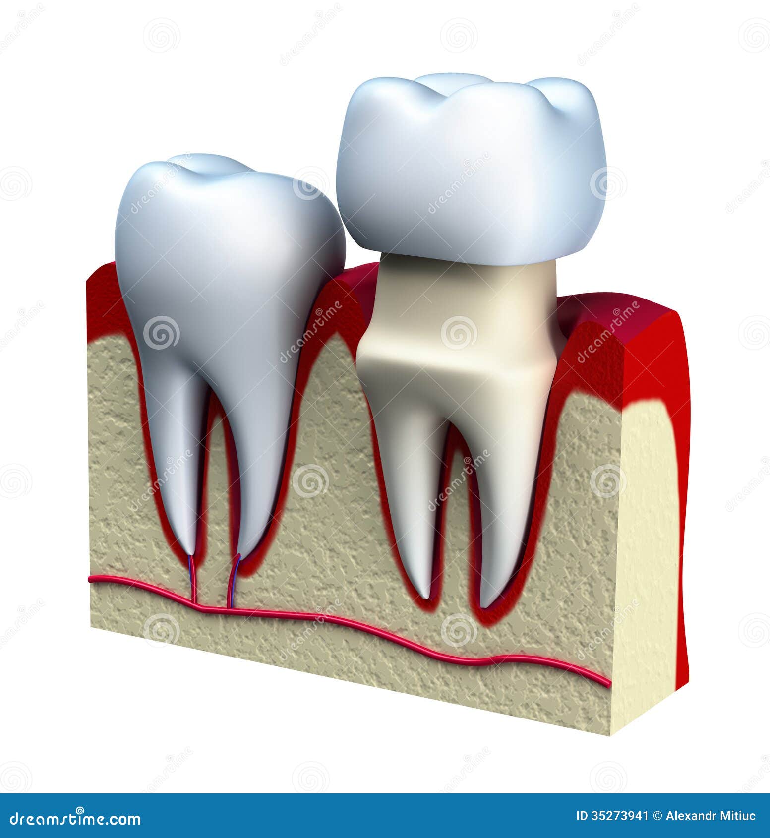 Dental Crown Installation Process, Isolated on White Stock Illustration ...