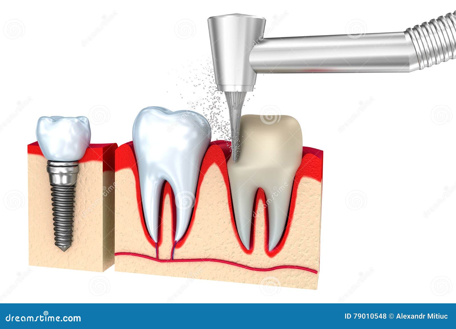 Dental Crown Installation Process Stock Illustration - Illustration of ...
