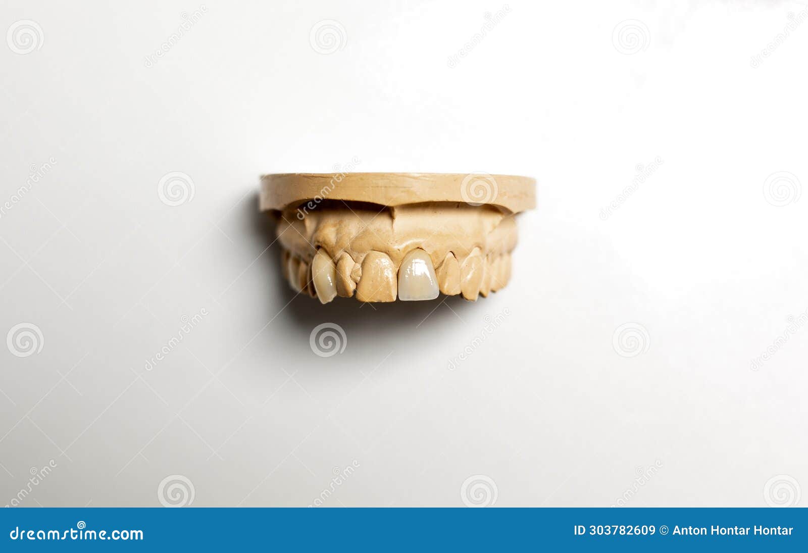 Dental Crowns. Close-up Ceramic Tooth Crown Stock Image - Image of ...