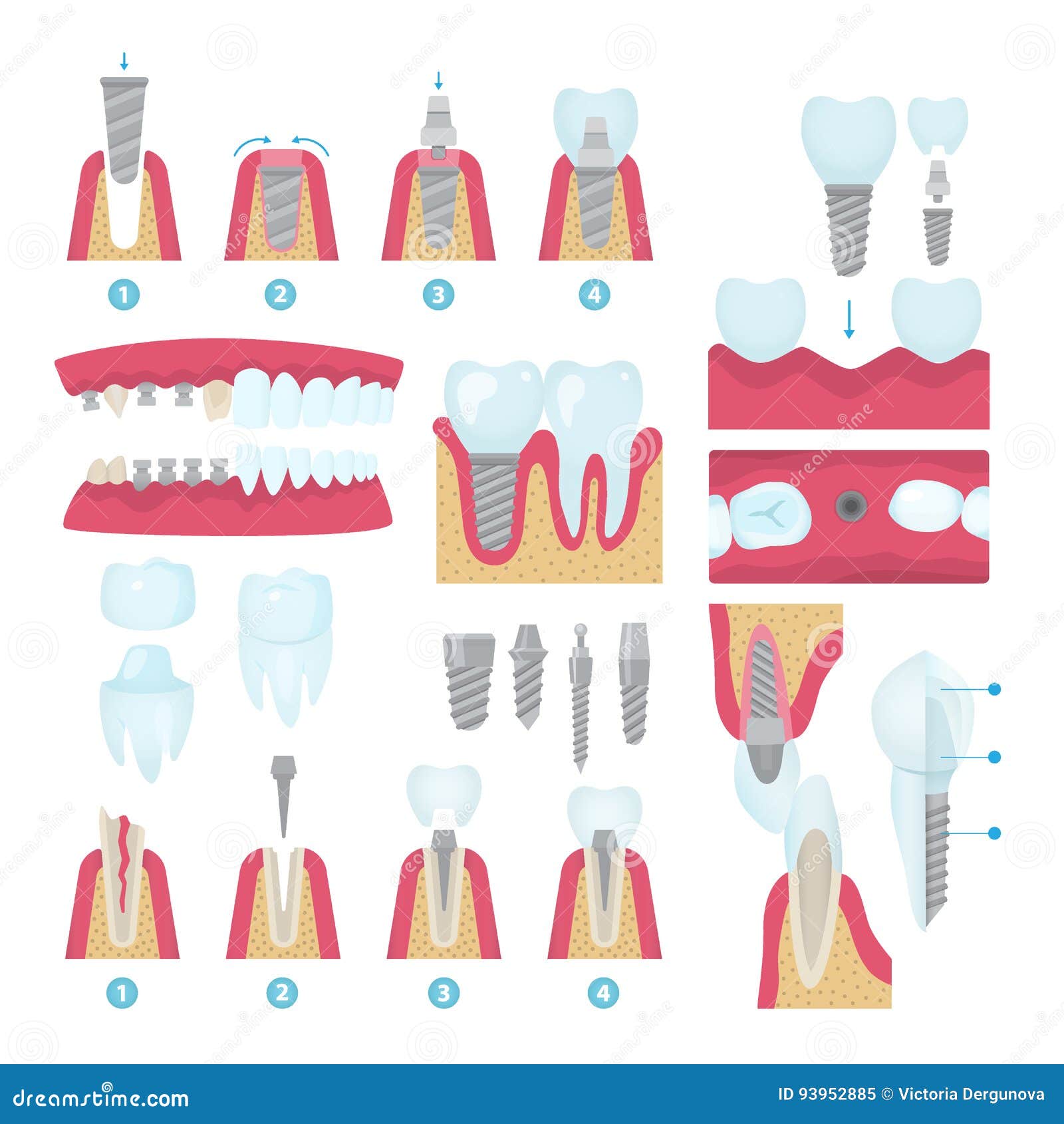 Dental Crowns and Implantation Stock Vector - Illustration of correct ...