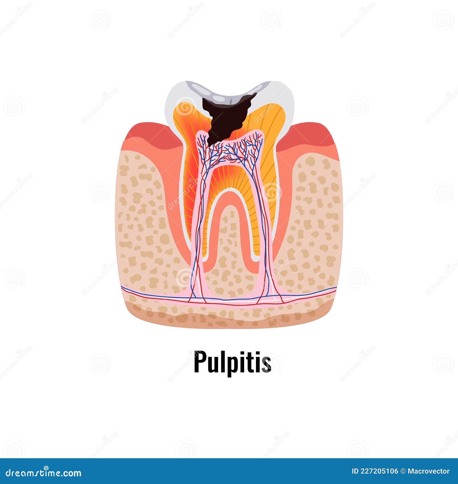 Dental Disease Linear Icon. Medical Illustration Of Tooth Root ...