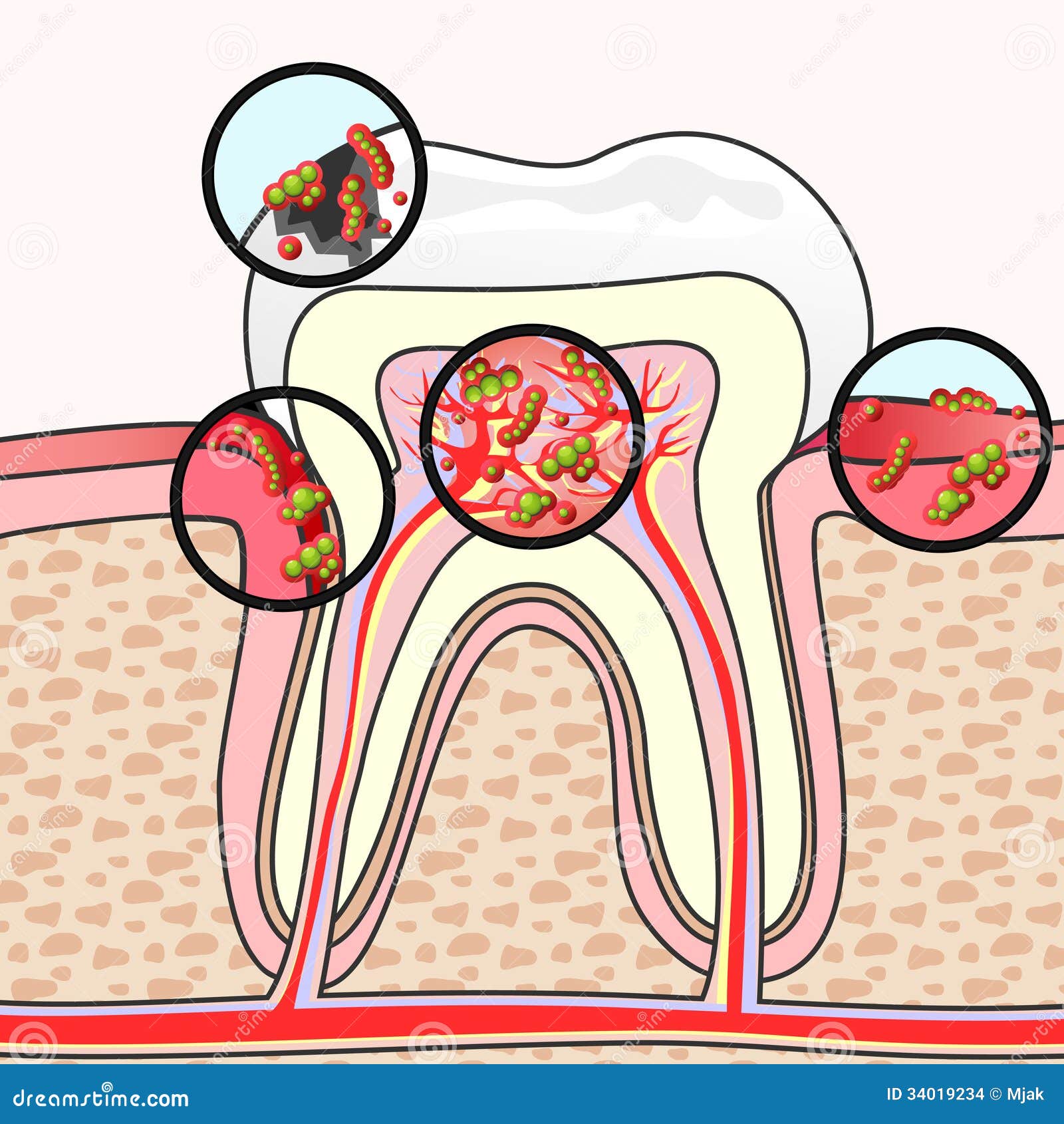 Dental diseases stock vector. Illustration of bacillus - 34019234