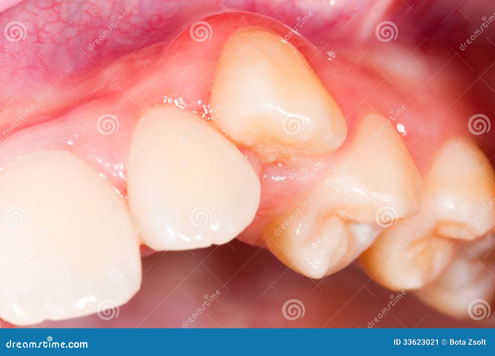 Dental displacement stock image. Image of human, malocclusion - 33623021