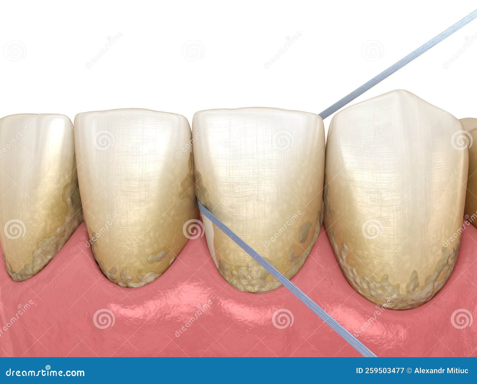 Dental Floss Cleaning Process. Medically Accurate Dental 3D ...
