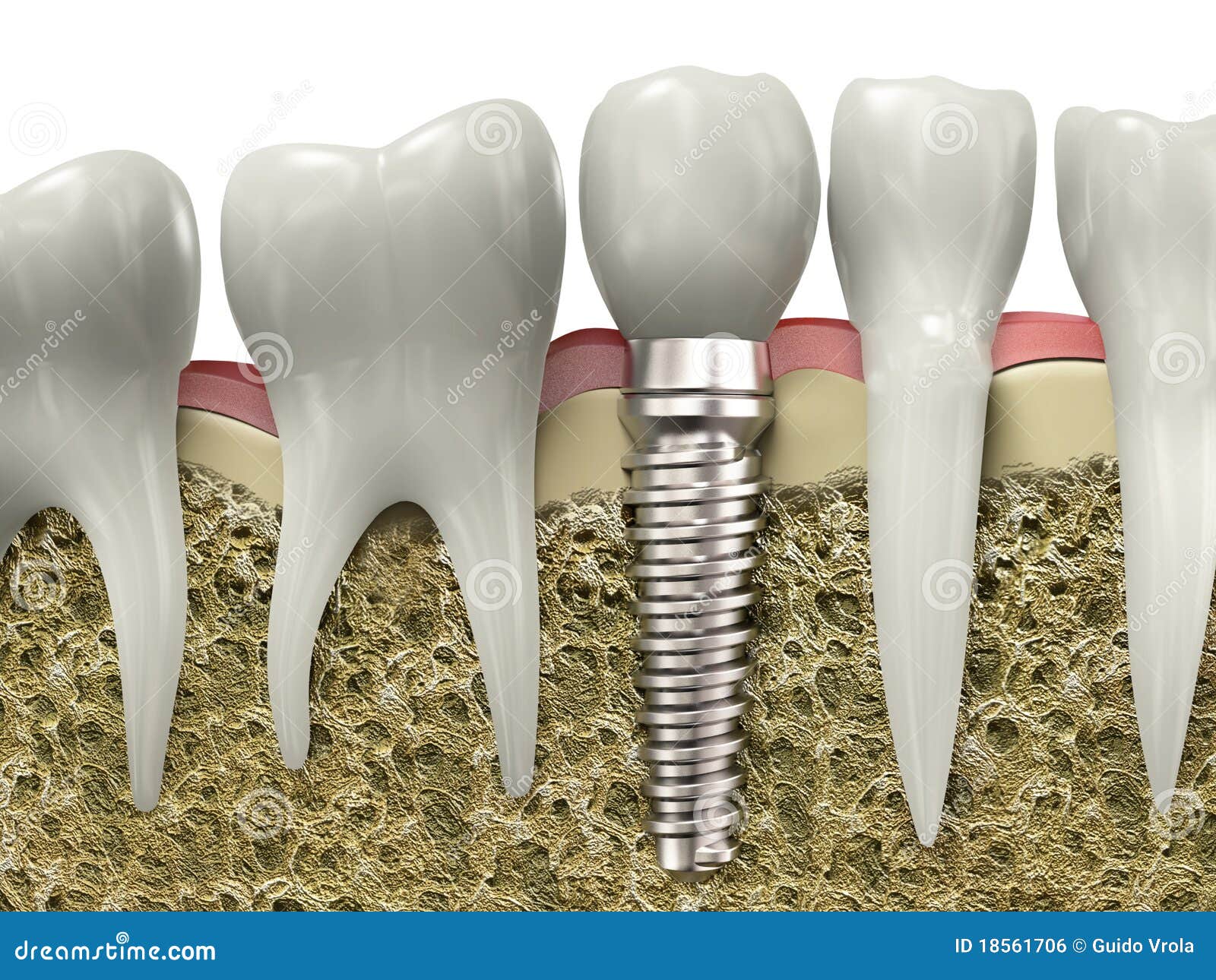 Dental implant stock illustration. Illustration of medical - 18561706