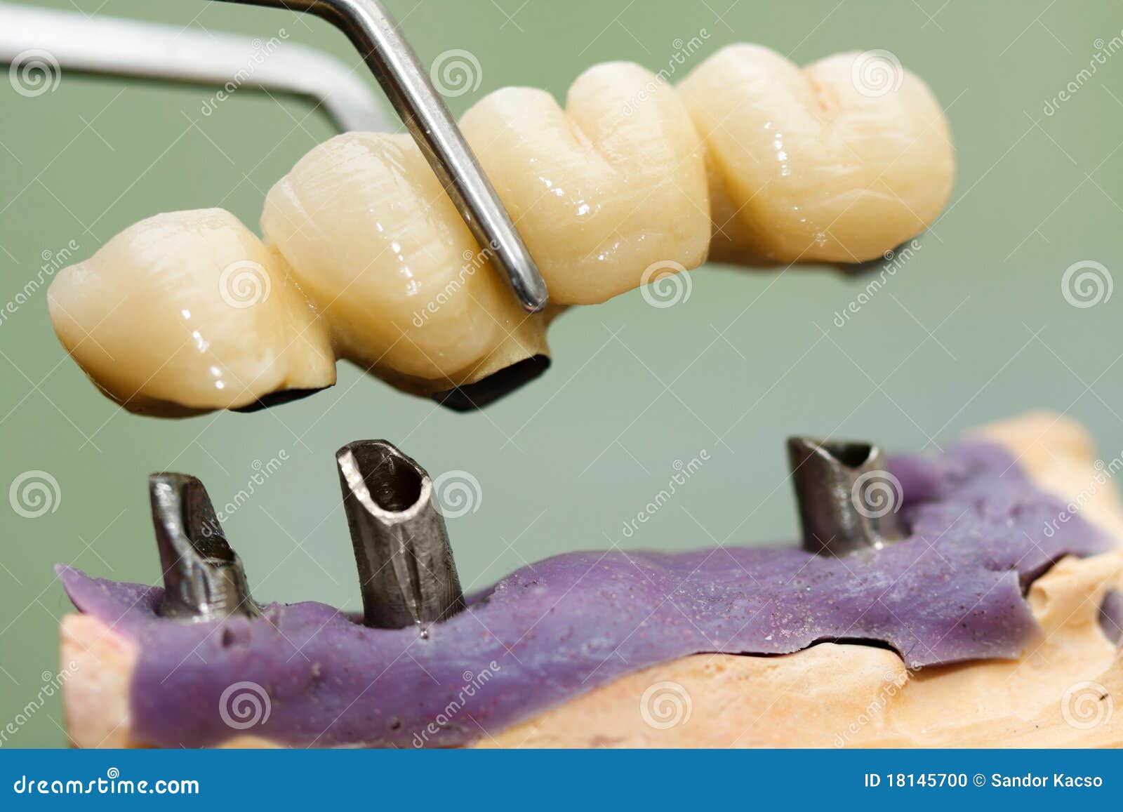 Dental Implant Head and Bridge Stock Photo - Image of prosthetics, cast ...