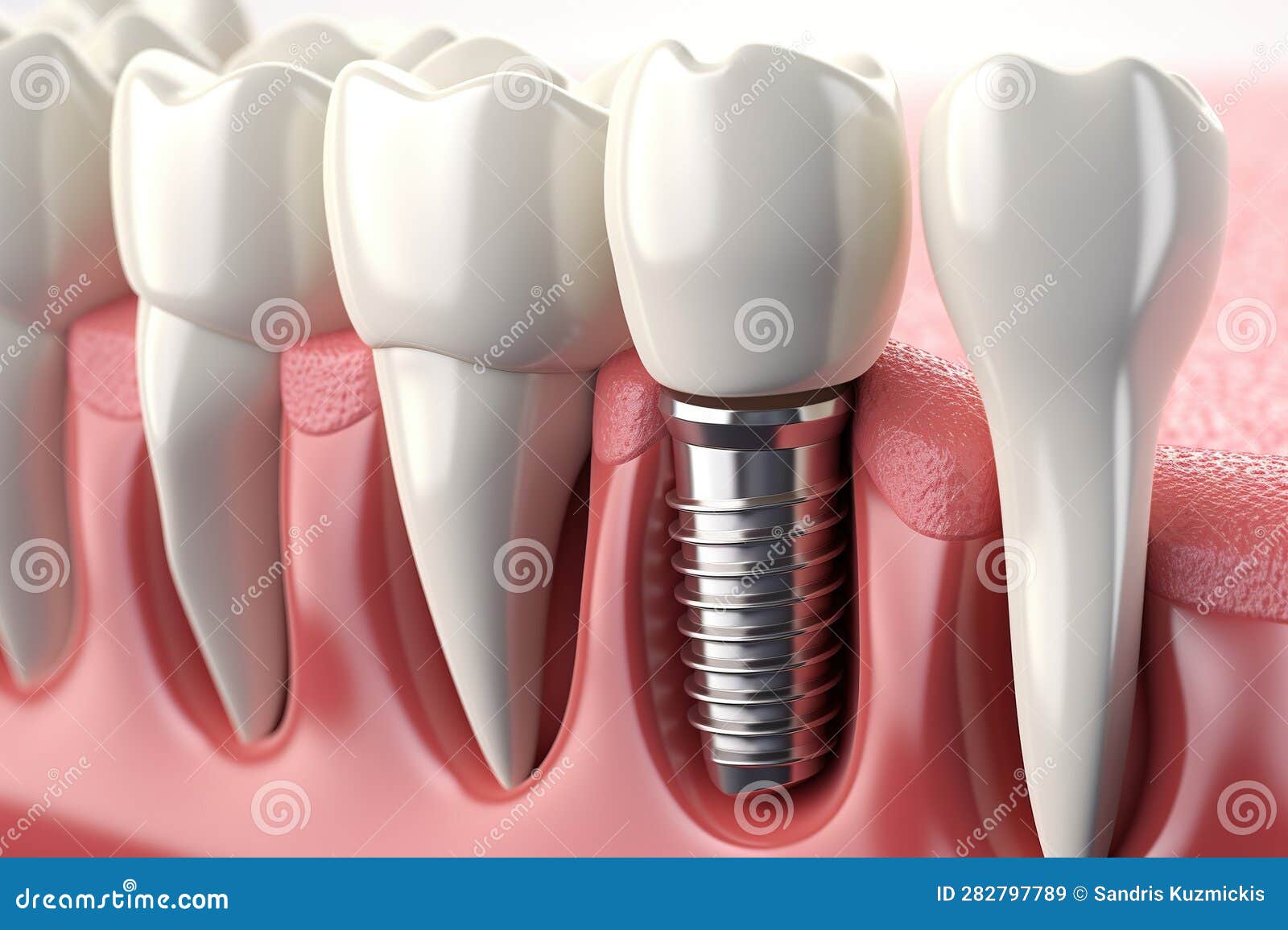 Dental Implant Illustration. Generative AI Stock Illustration ...