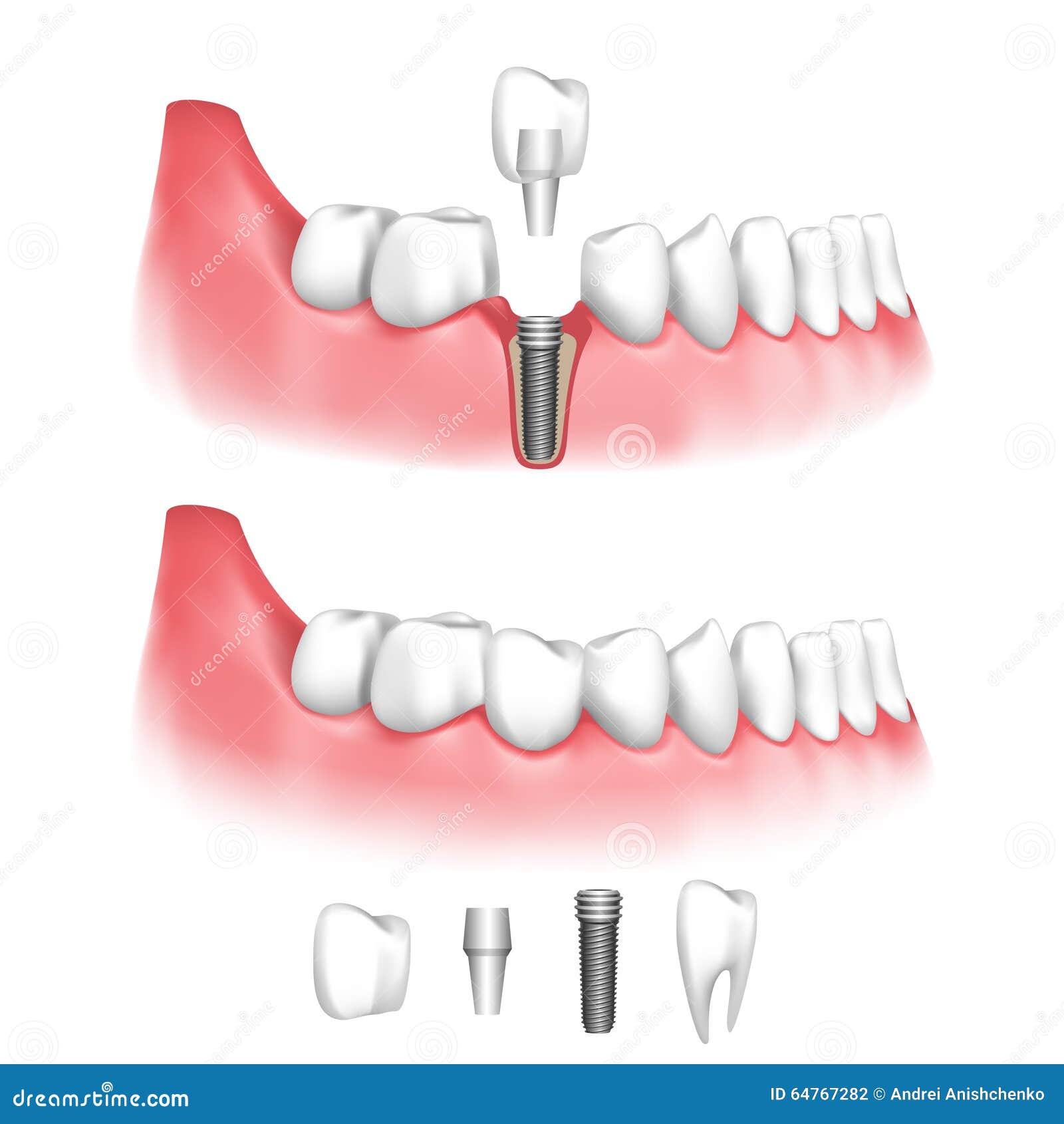 Dental implant stock vector. Illustration of procedure - 64767282
