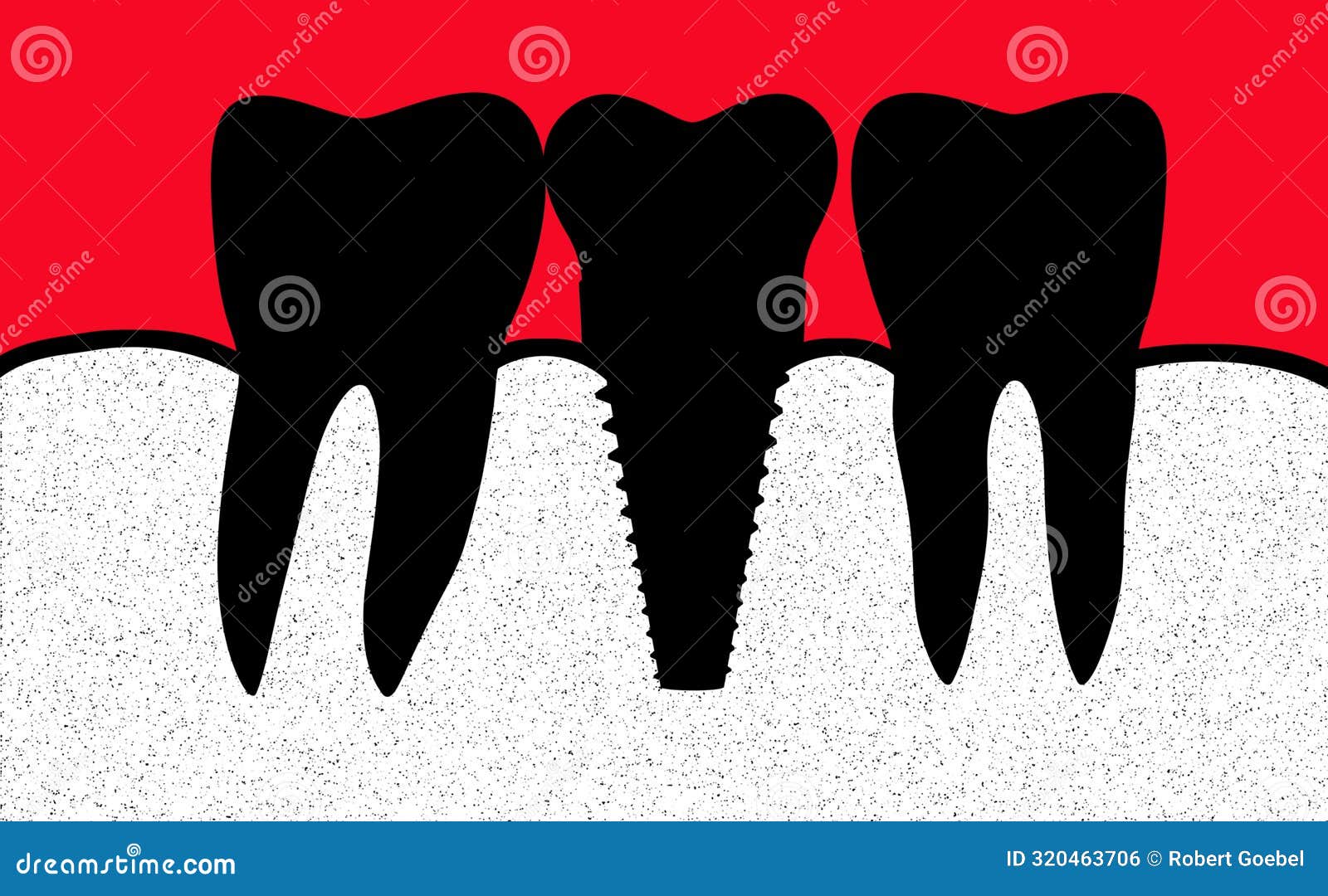 A Dental Implant, an Implanted Tooth is Seen between Two Normal Teeth ...