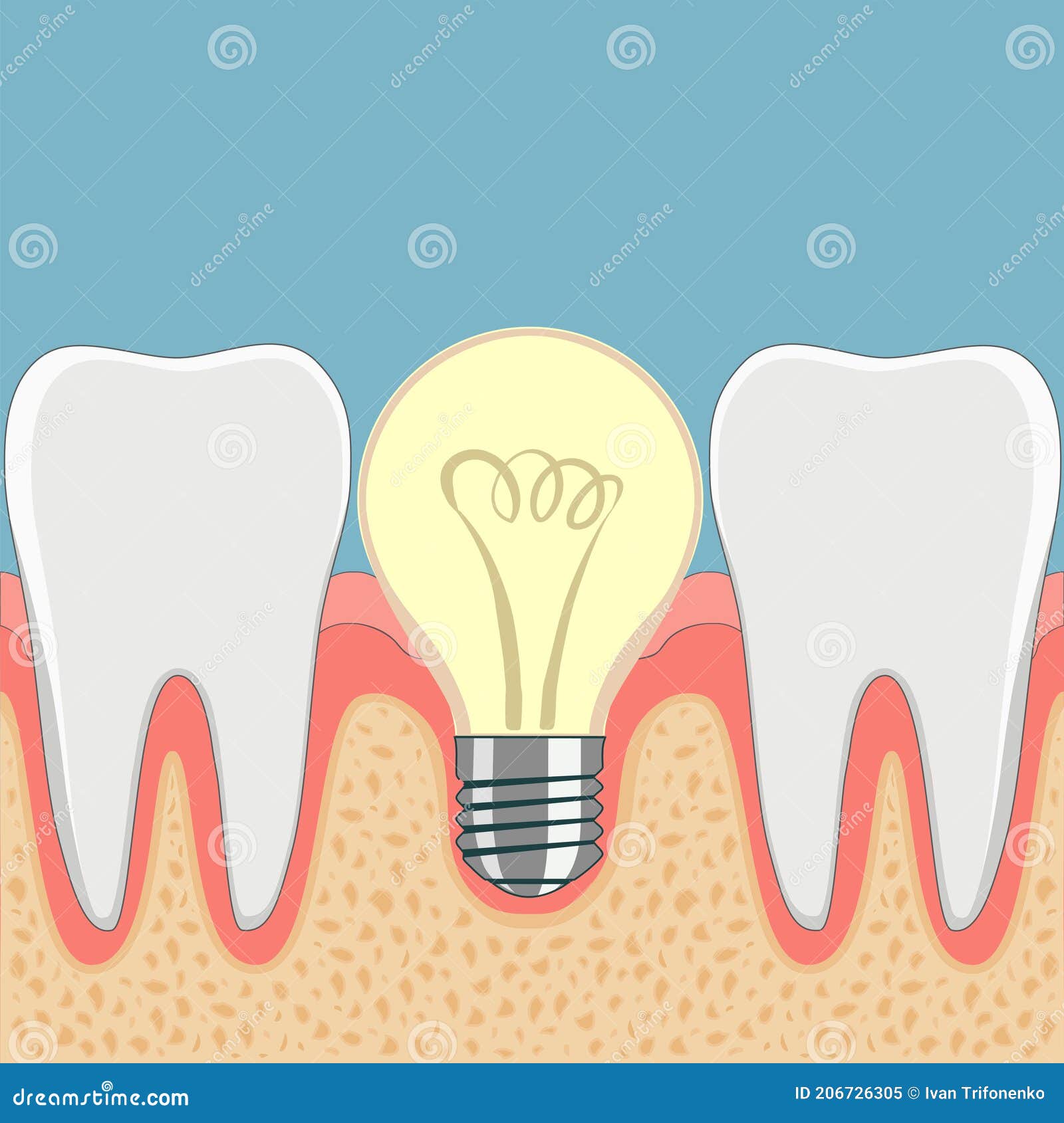 Dental Implant. Light Bulb between Teeth Stock Vector - Illustration of ...