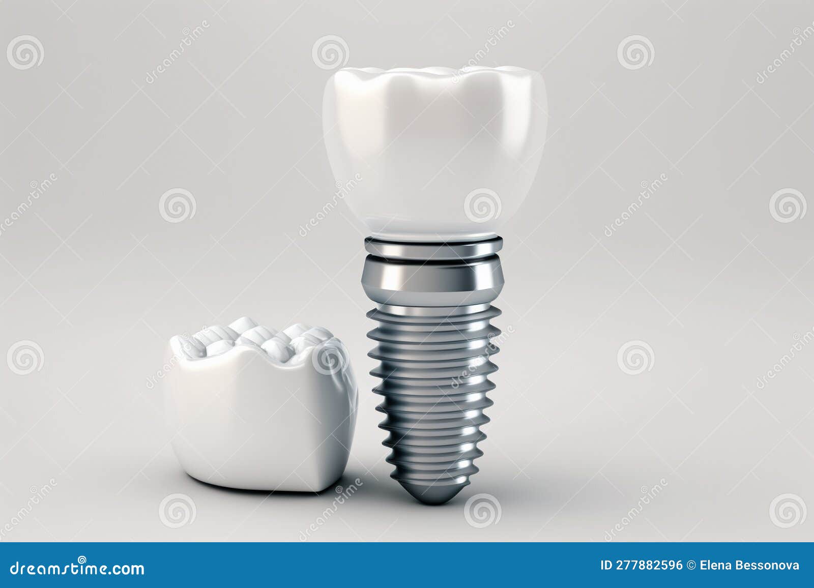 Dental Implant Model of Molar Tooth As a Concept of Implantation Teeth ...