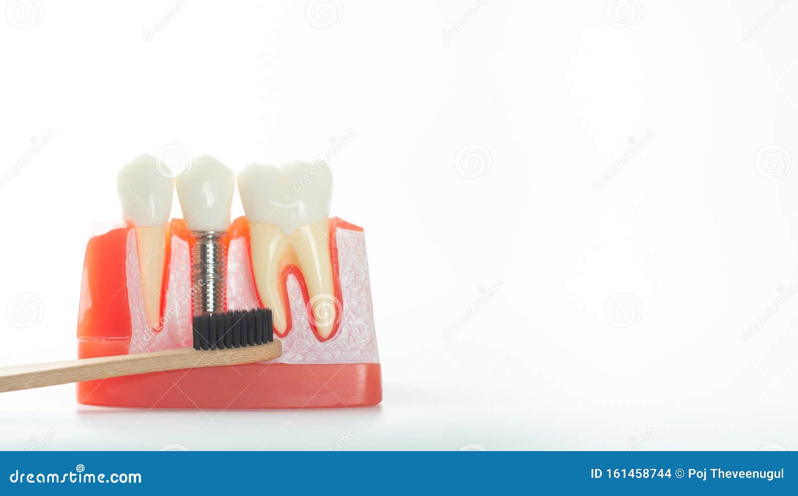 Dental Implant Model on White Background Stock Photo - Image of molar ...