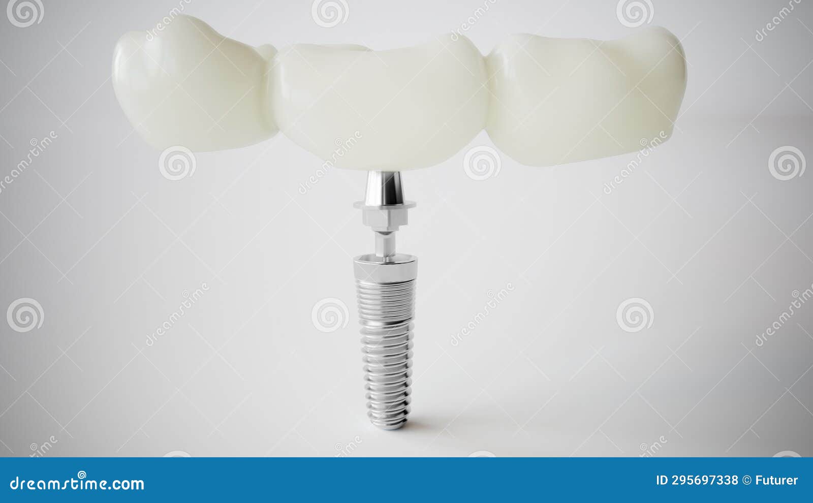 Dental Implant: Modern Solution for Tooth Replacement Stock Photo ...