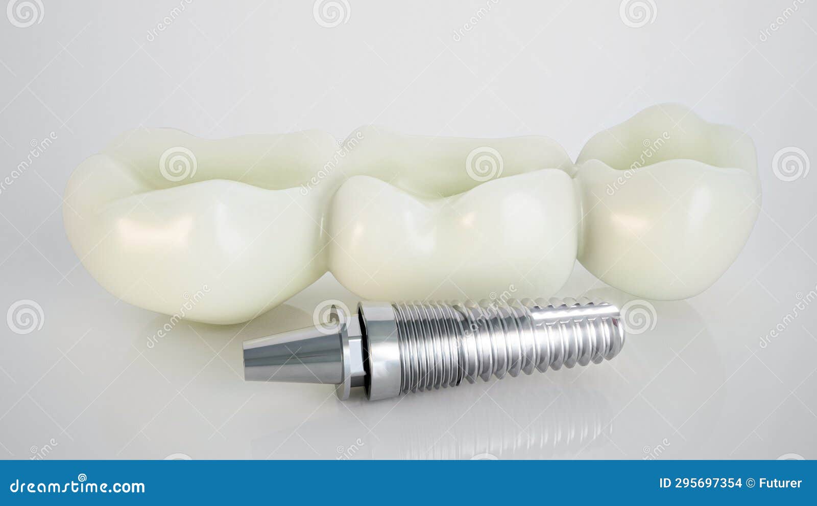 Dental Implant: Modern Solution for Tooth Replacement Stock Photo ...