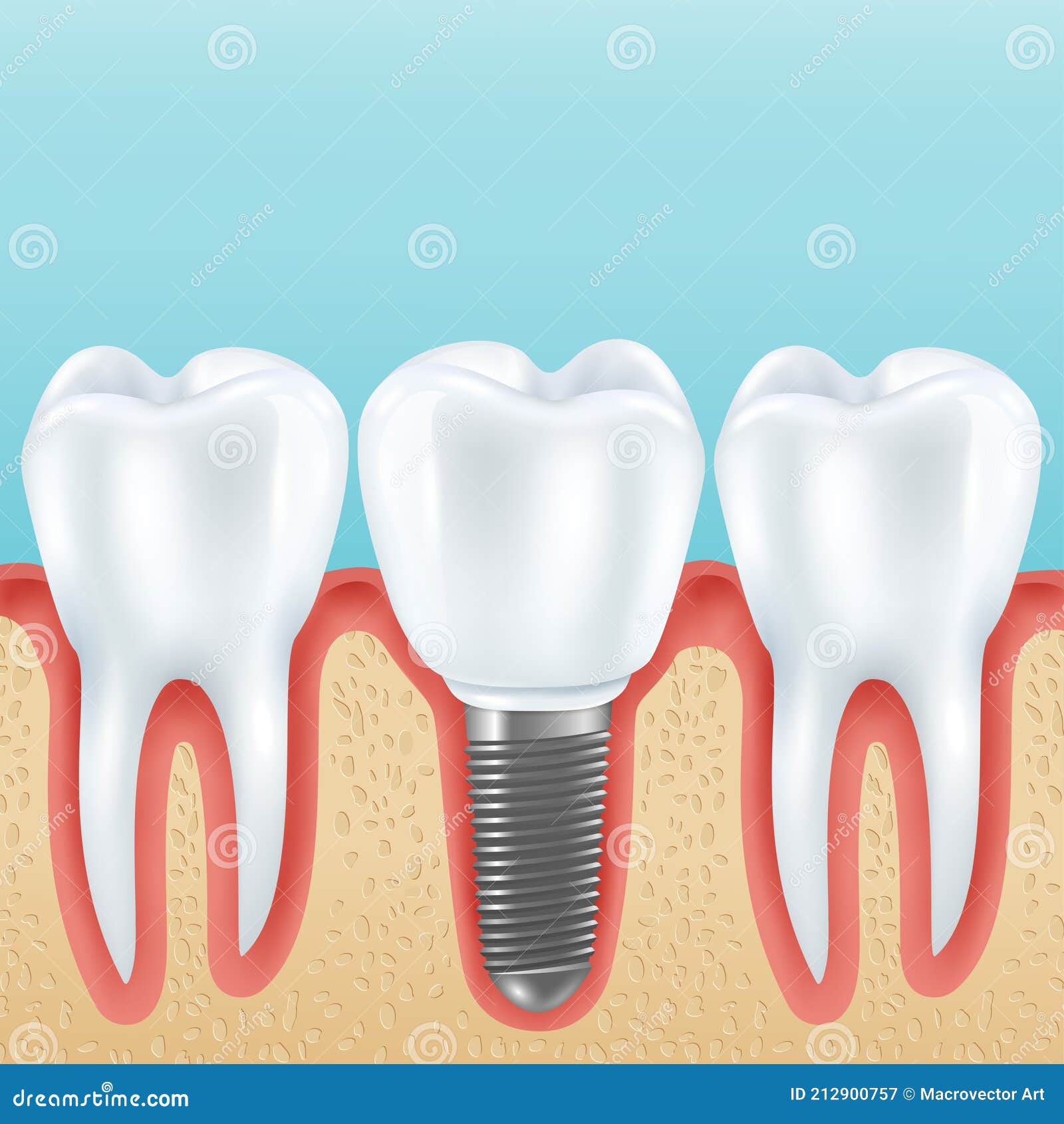 Dental Implant Realistic Illustration Stock Vector - Illustration of ...