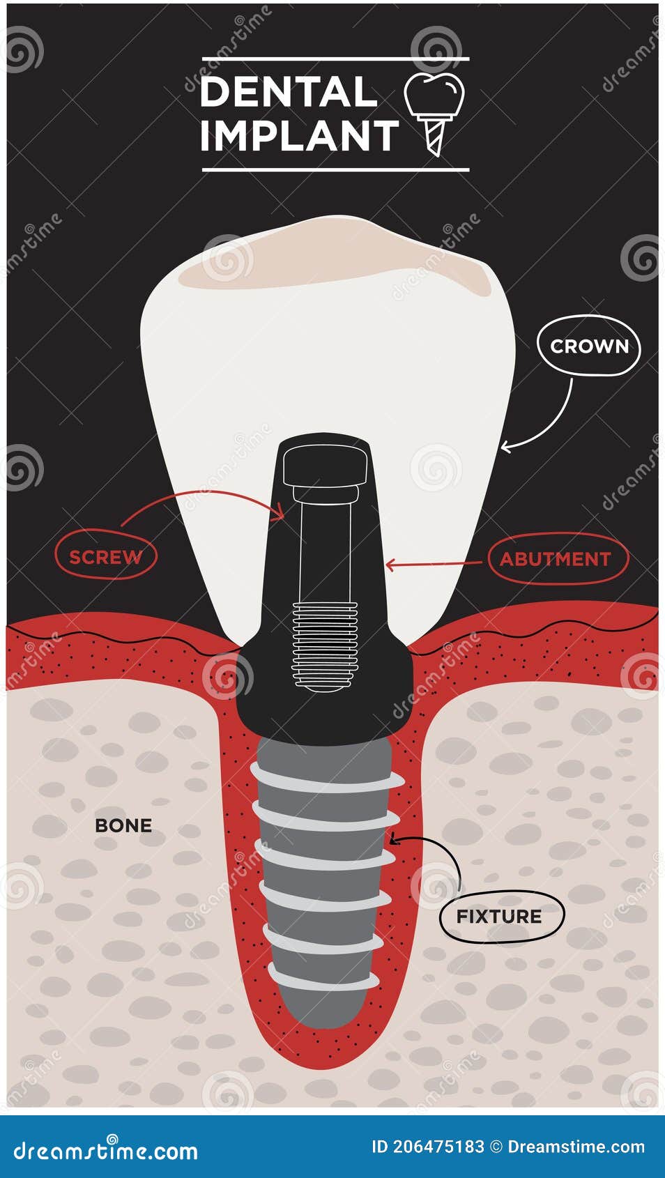 Dental Implant Structure. Medical Educative Infographic Stock Vector ...