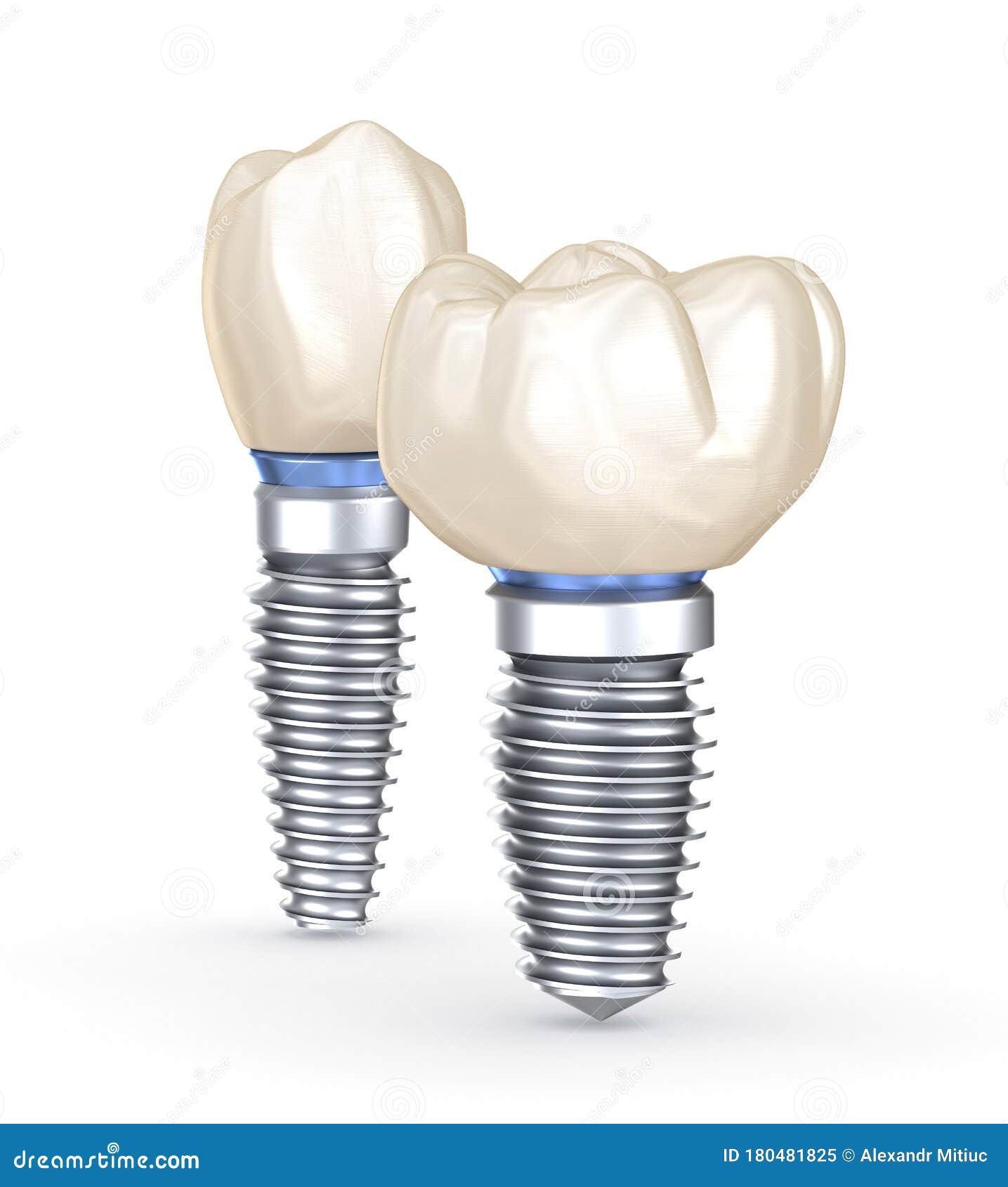 Dental Implants. Illustration Concept of Human Teeth Stock Illustration ...
