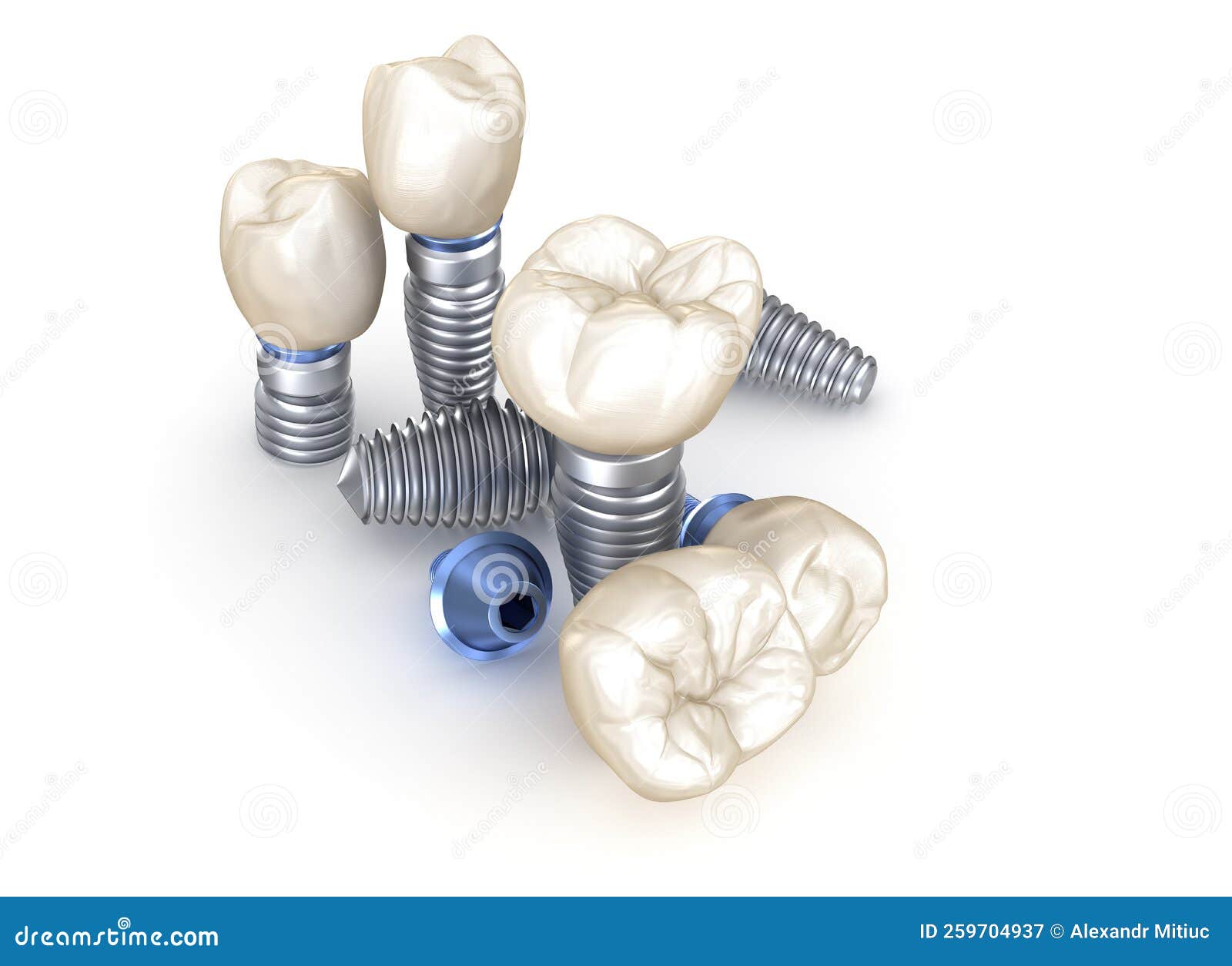Dental Implants. 3D Illustration Concept of Human Teeth Stock ...