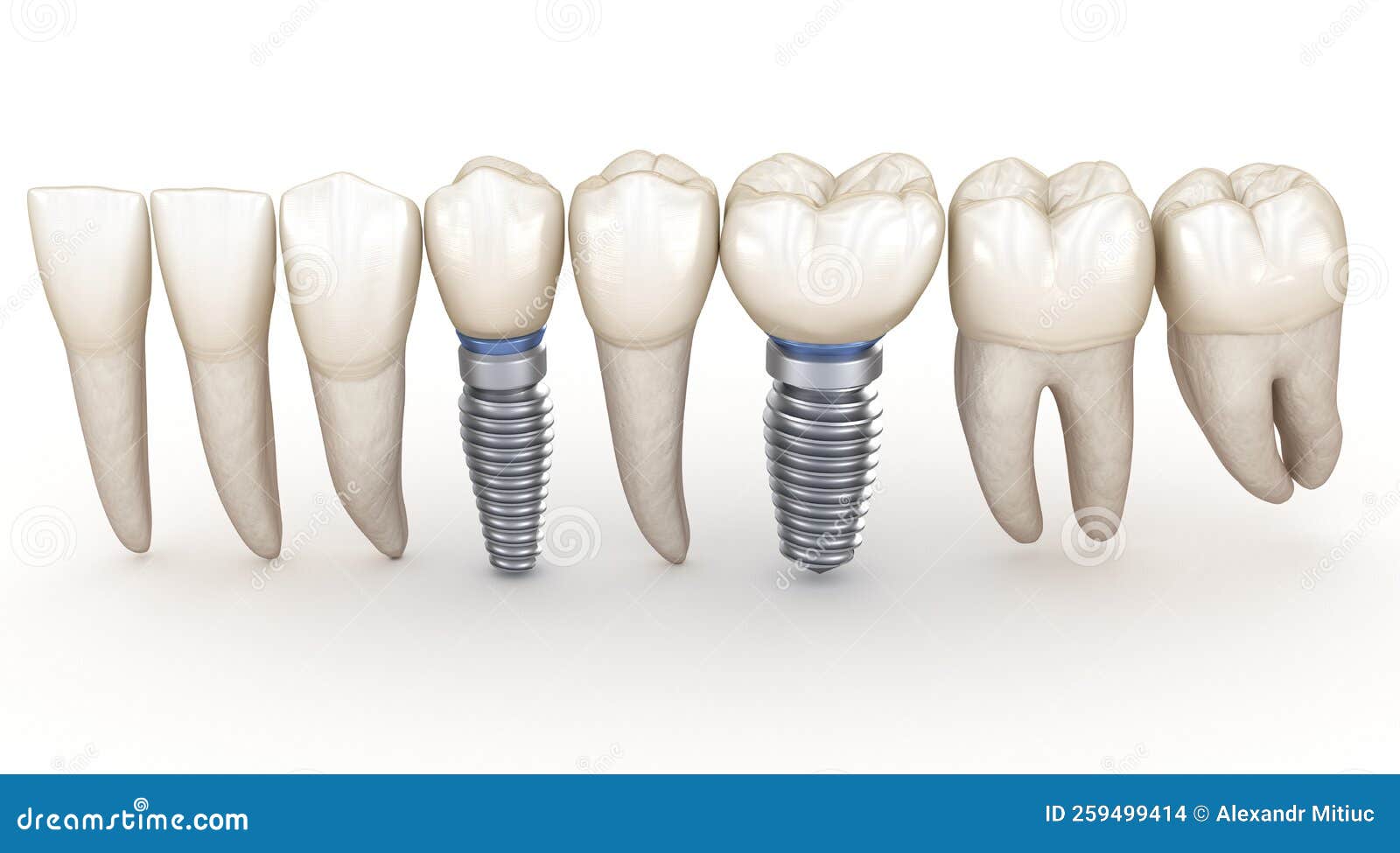 Dental Implants in Line. 3D Illustration Concept of Human Teeth Stock ...