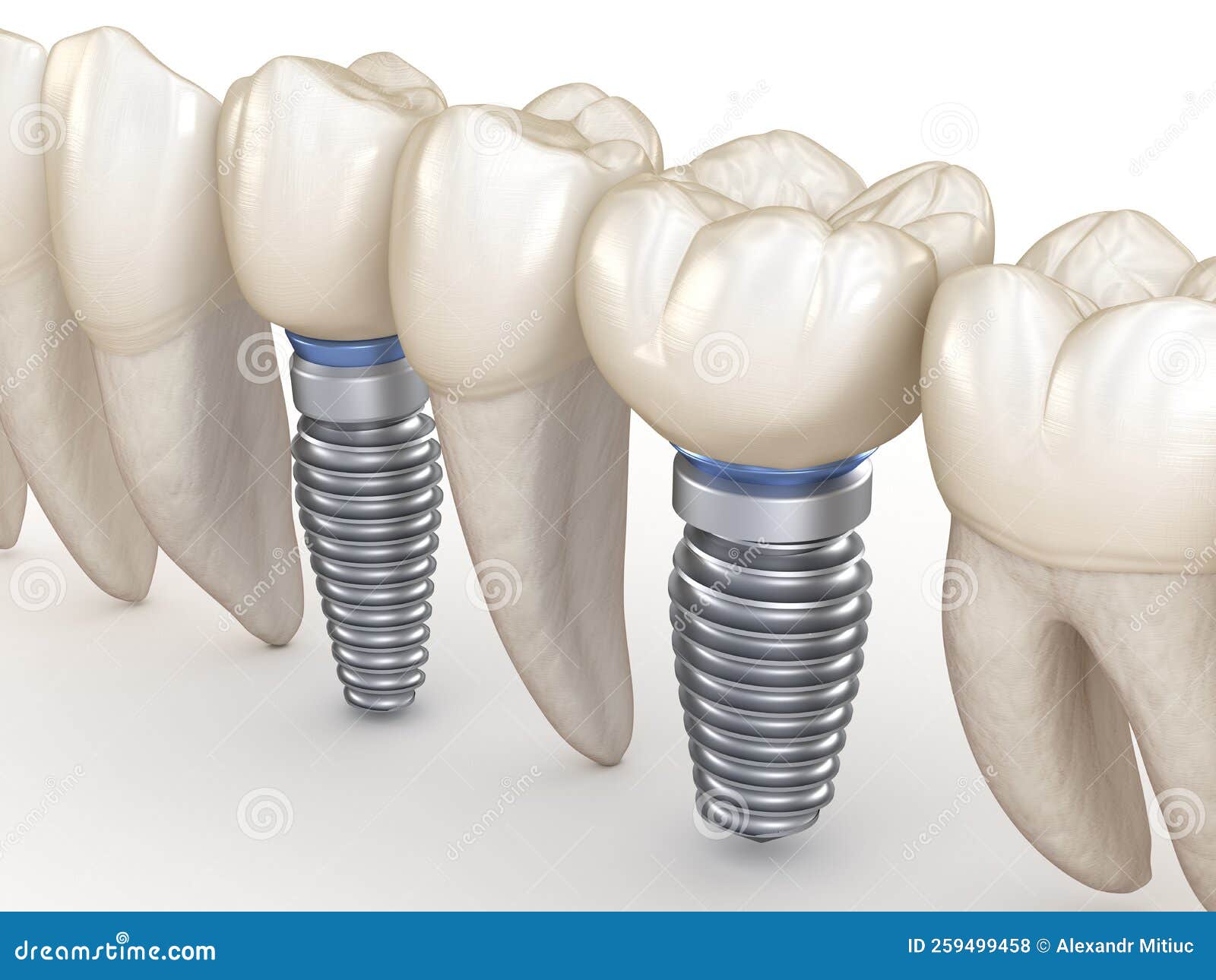 Dental Implants in Line. 3D Illustration Concept of Human Teeth Stock ...