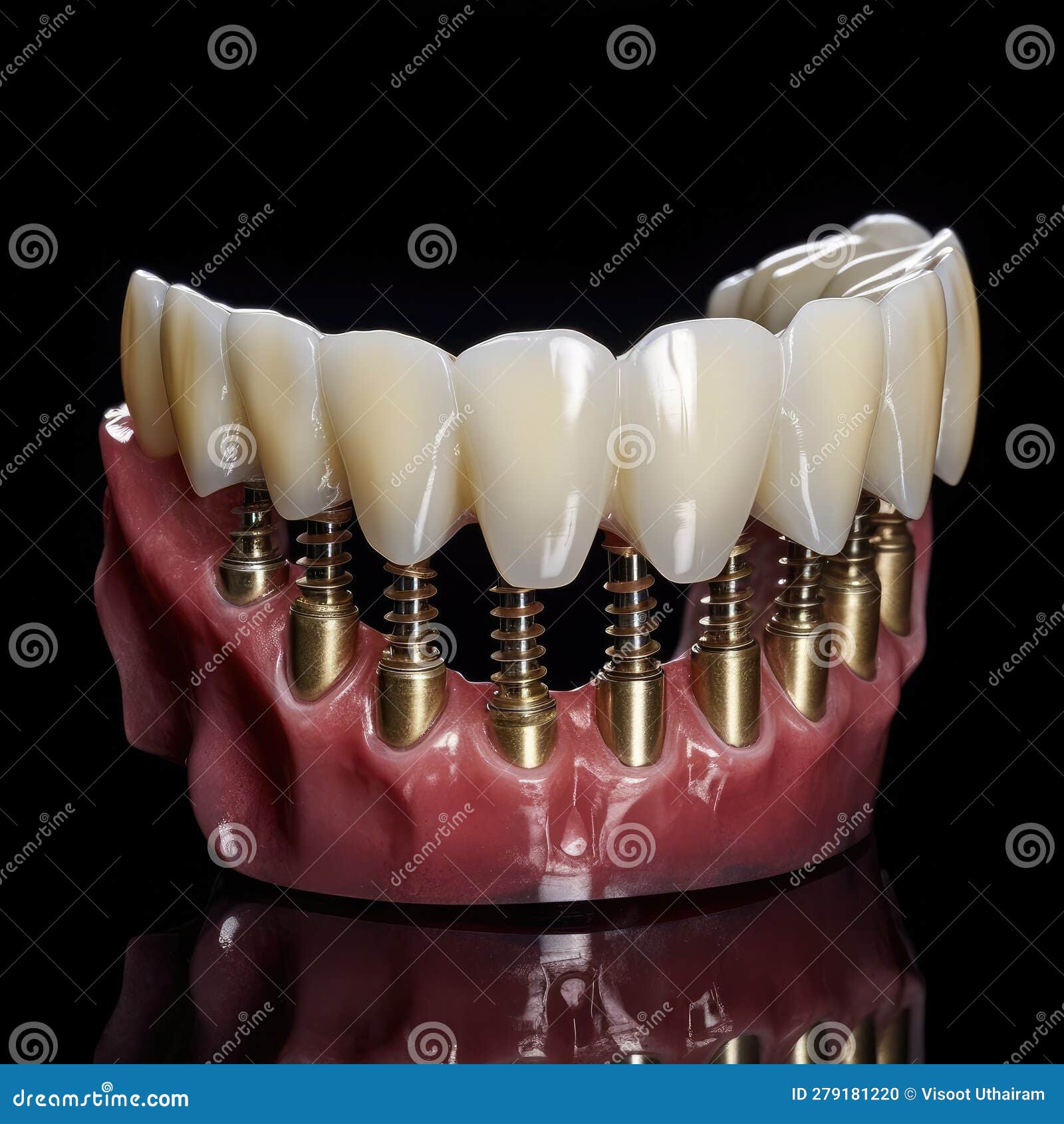 Dental Implants,Modern Dental Implants,AI Generated Stock Illustration ...