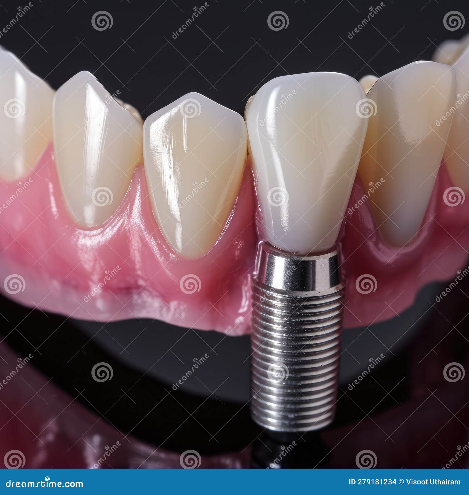 Dental Implants,Modern Dental Implants,AI Generated Stock Illustration ...