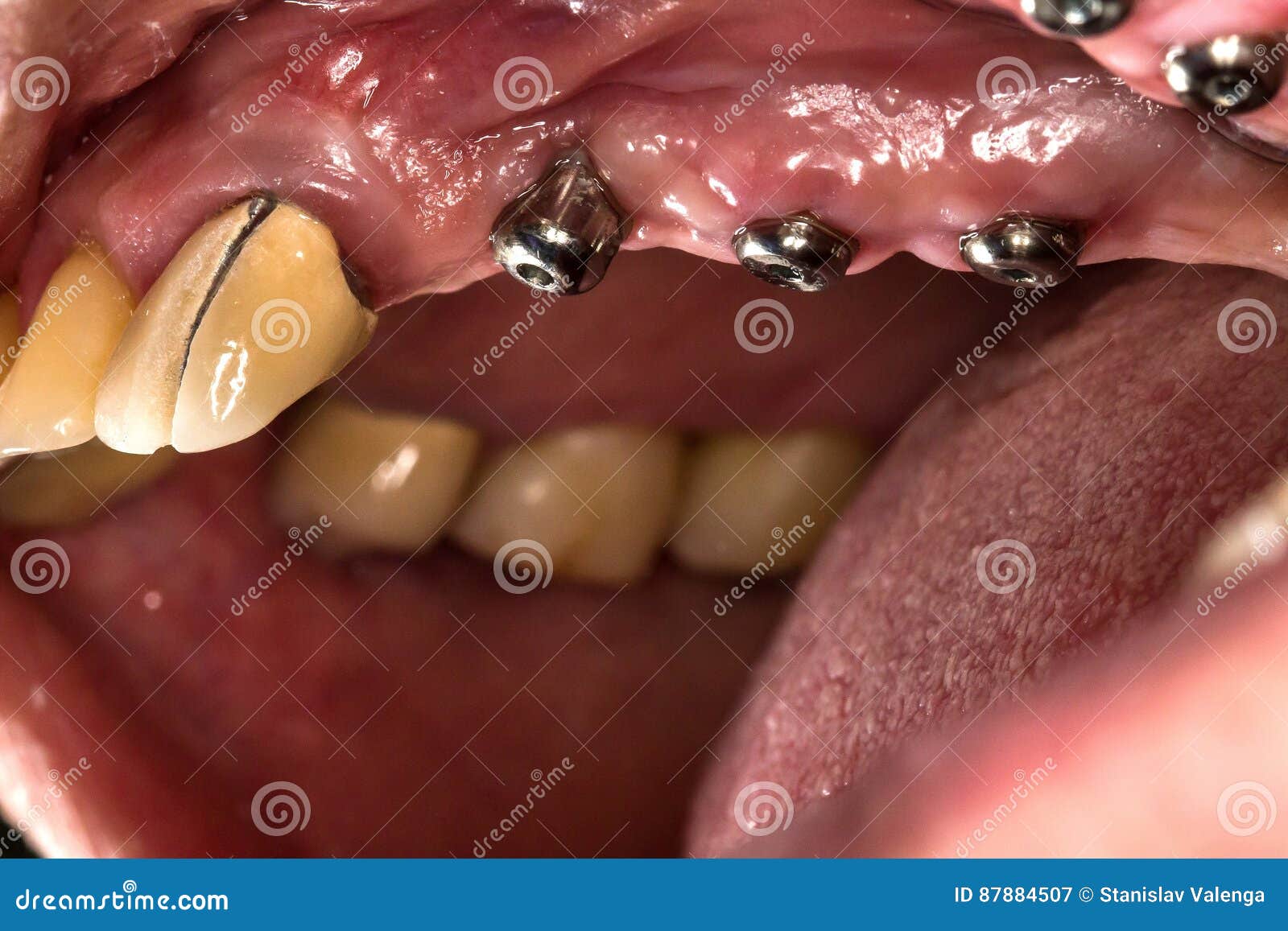 Dentist Implantologist Shows A Patient A Jaw With Implants And Veneer ...