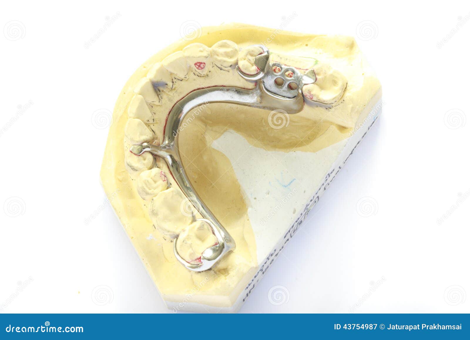 Dental Impression Model with Laboratory Metal Framework Stock Image ...