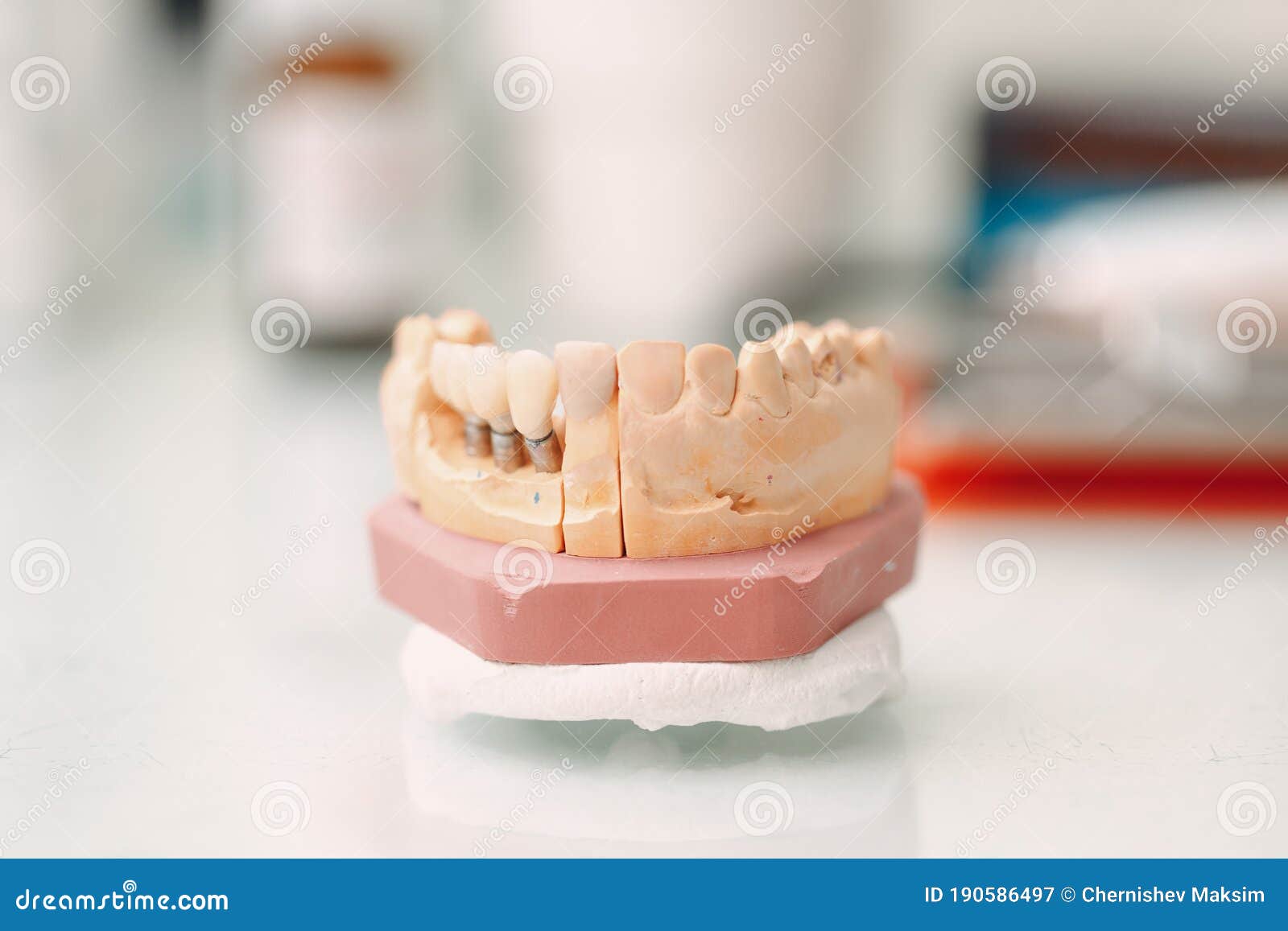 Dental Layout of the Human Jaw with Teeth and Implants. Stock Image ...