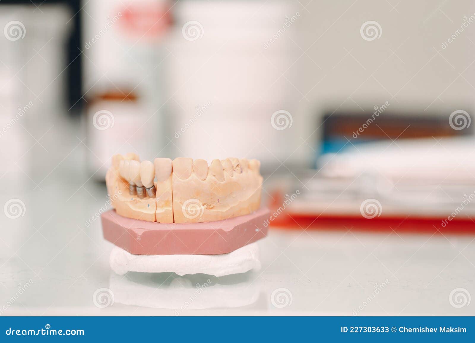 Dental Layout of the Human Jaw with Teeth and Implants. Stock Image ...