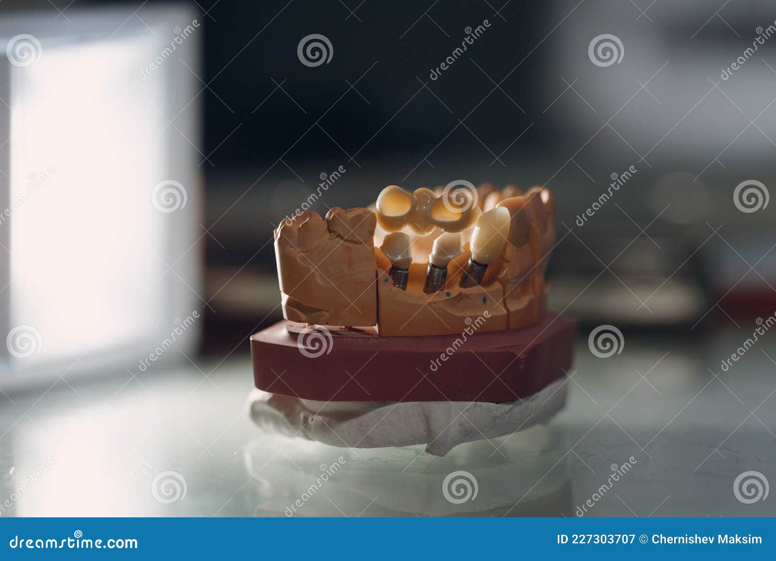 Dental Layout of the Human Jaw with Teeth and Implants. Stock Image ...