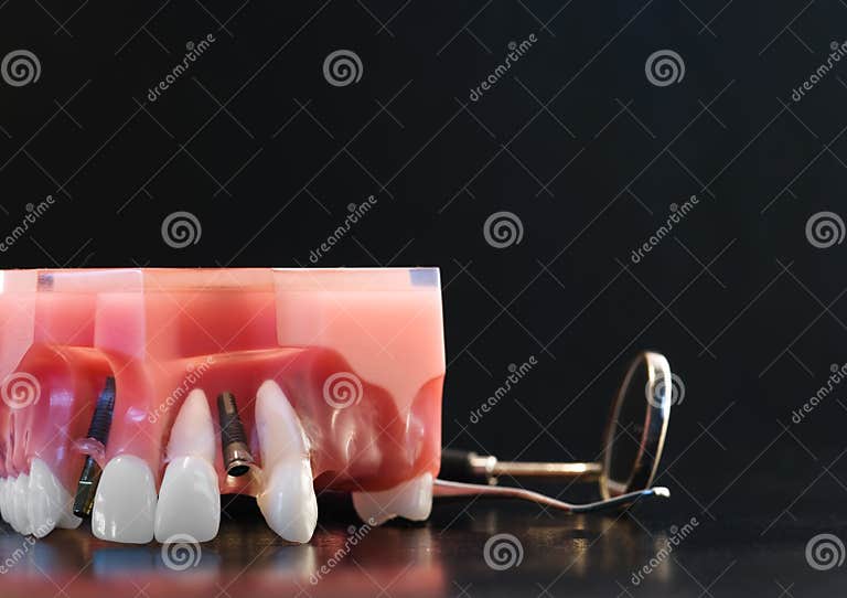 Dental model stock image. Image of model, health, overbite - 12859865
