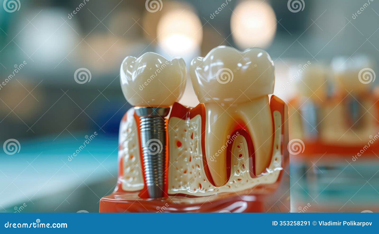 Dental Model Showing Missing Tooth, Suitable for Dental Clinic Websites ...