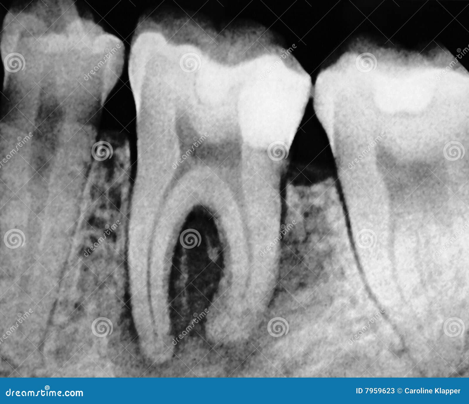 Dental Molar X-ray stock image. Image of contrast, mouth - 7959623