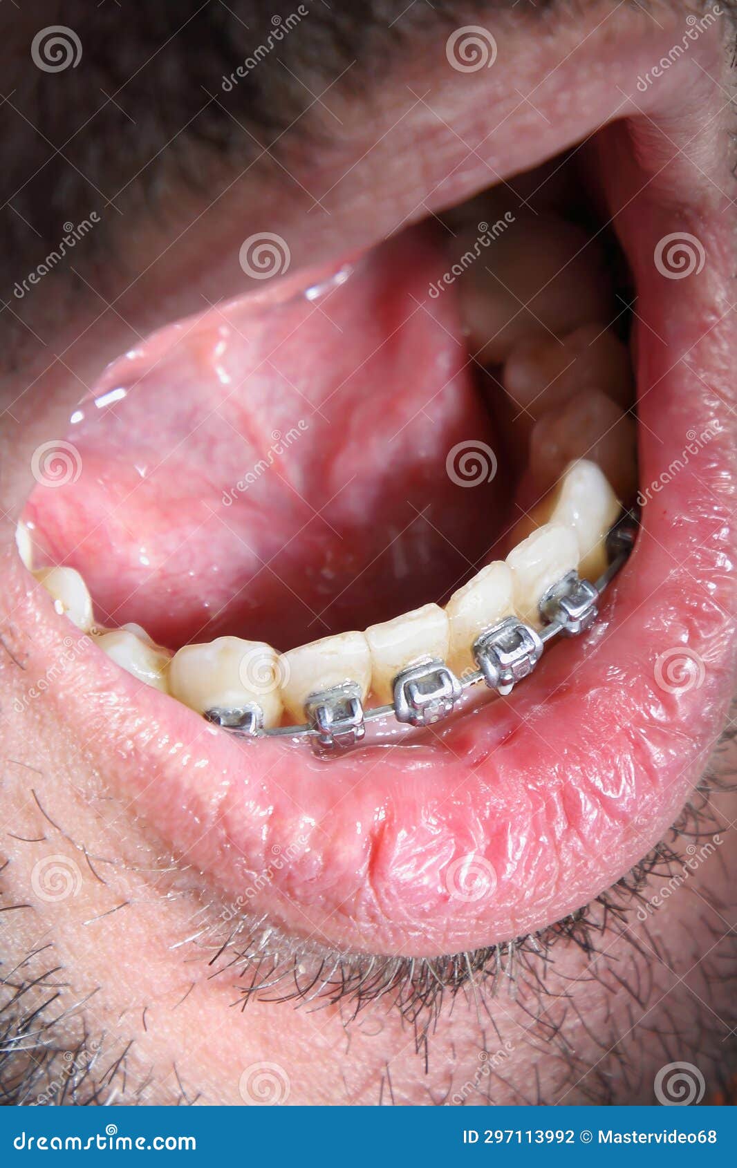 Dental Office. Installation of Dental Braces at the Dentist. the ...