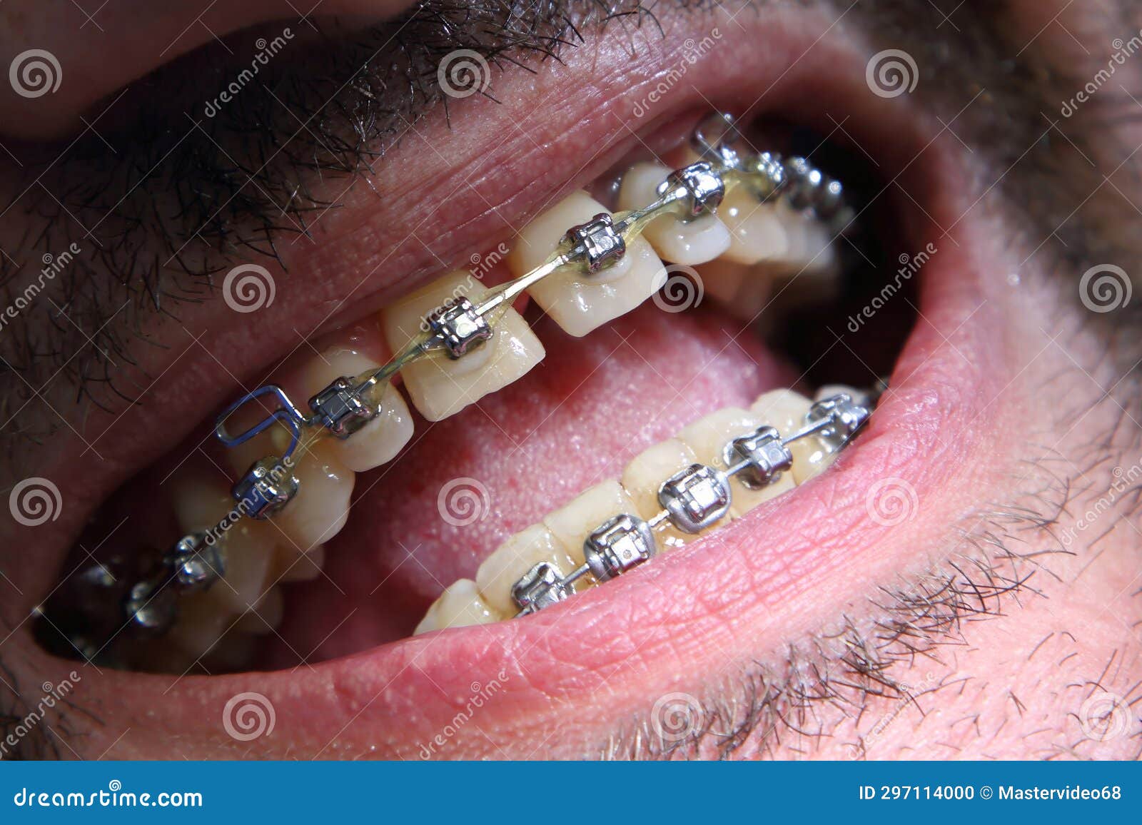 Dental Office. Installation of Dental Braces at the Dentist. the ...
