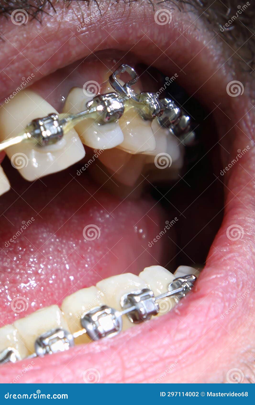 Dental Office. Installation of Dental Braces at the Dentist. the ...