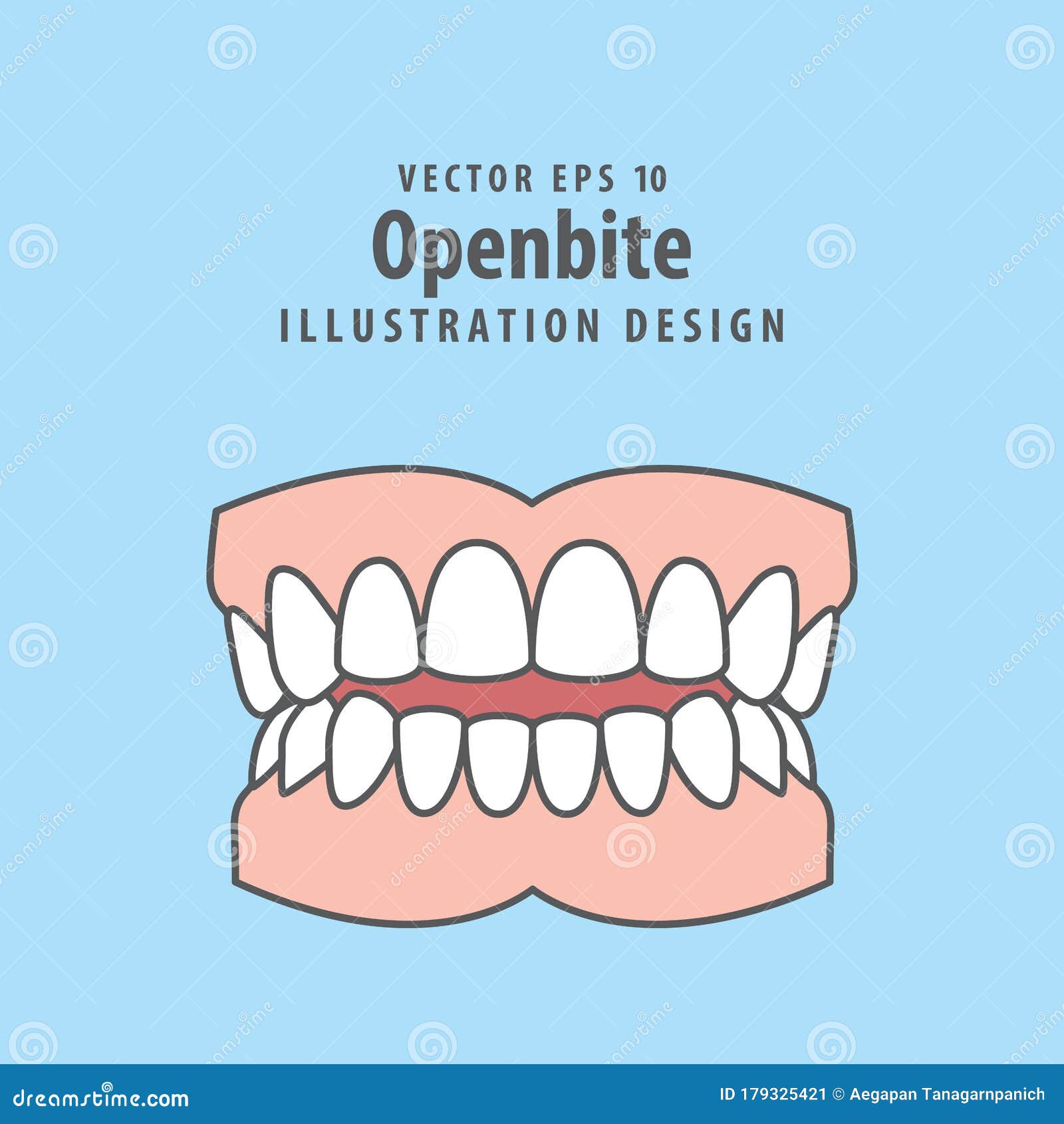 Openbite Dental Occlusion Malocclusion Of Teeth . Medically Accurate ...
