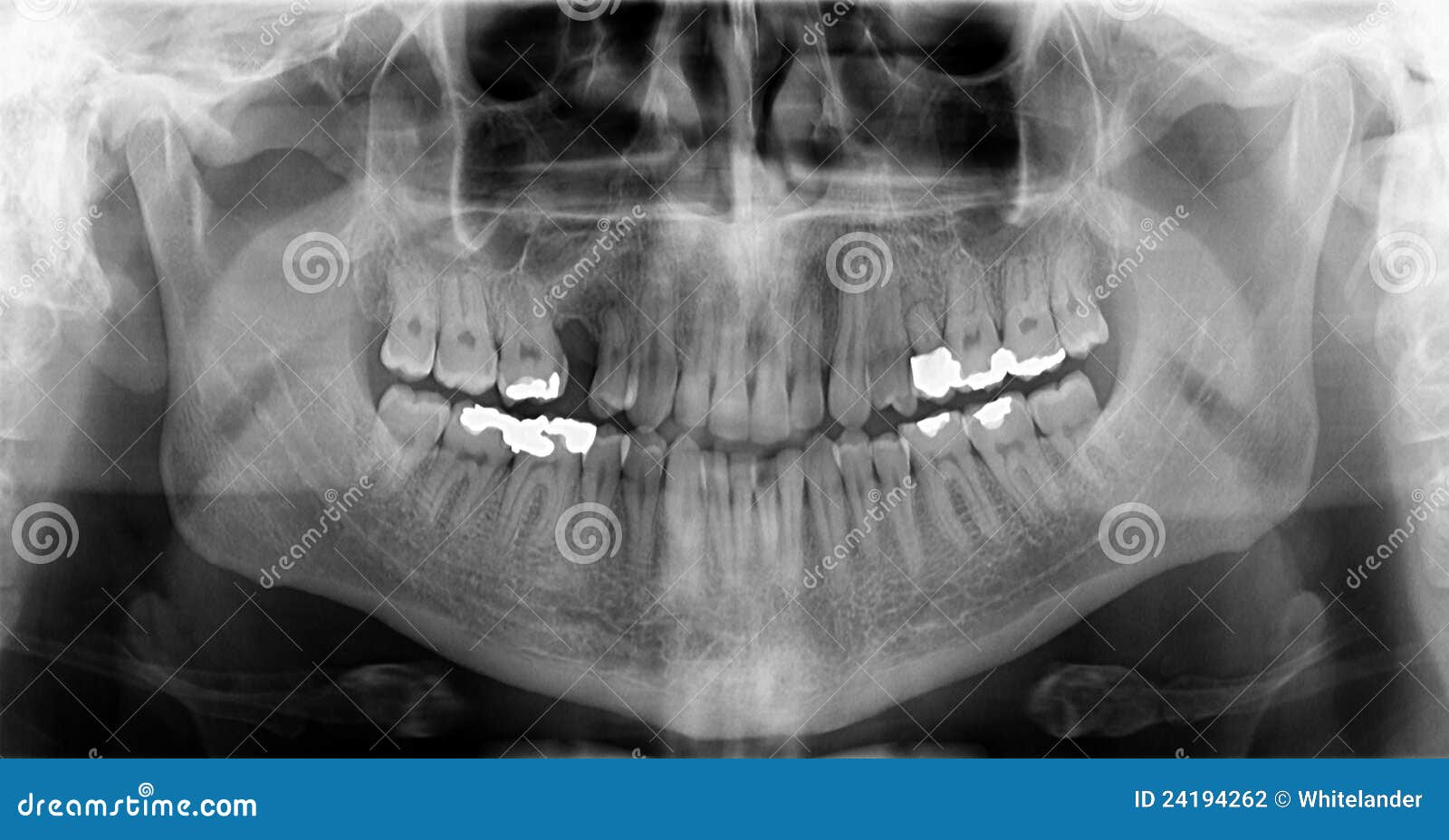 Dental orthopantomogram stock photo. Image of teeth, panoramic - 24194262