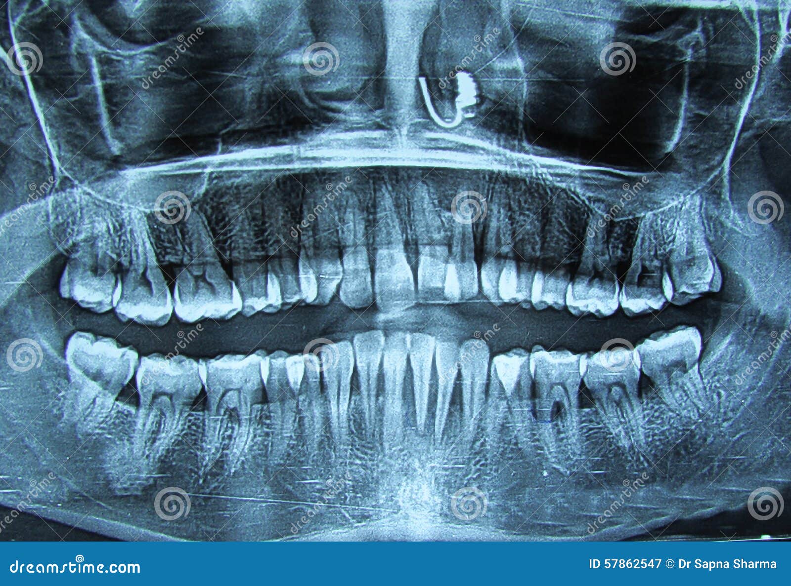 Dental Orthopantomogram stock image. Image of teeth, complete - 57862547
